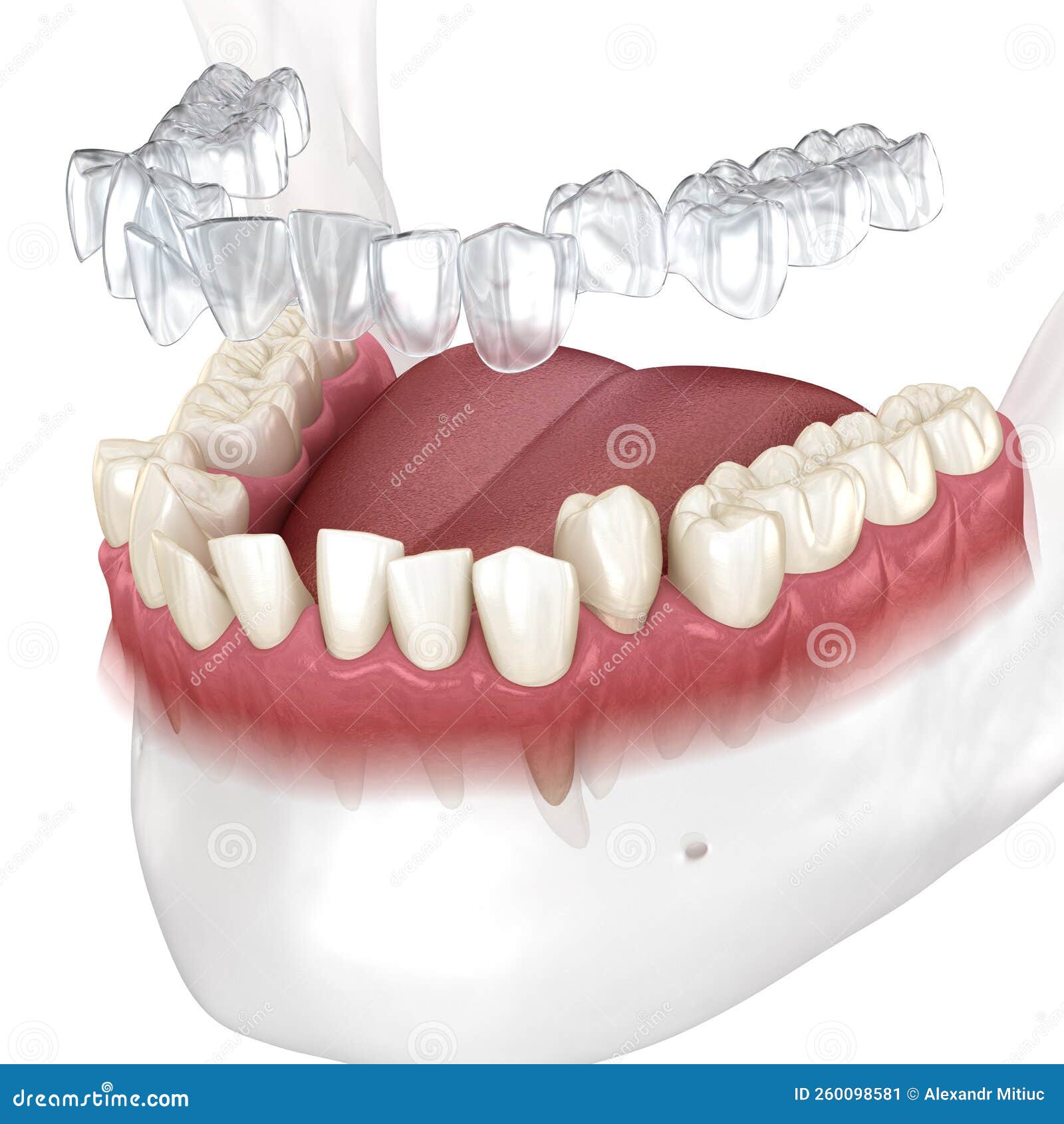 Invisalign Braces or Invisible Retainer Make Bite Correction. Medically ...