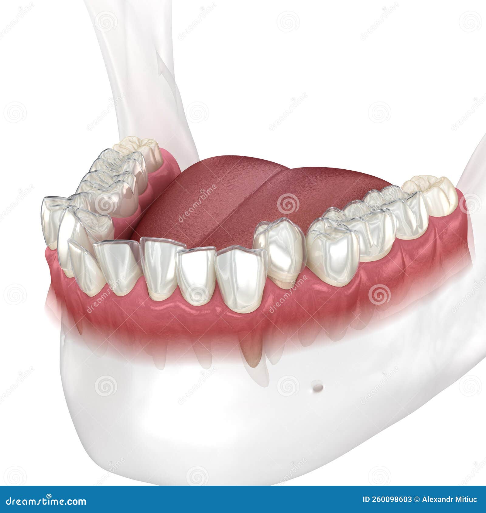 Invisalign Braces or Invisible Retainer Make Bite Correction. Medically ...