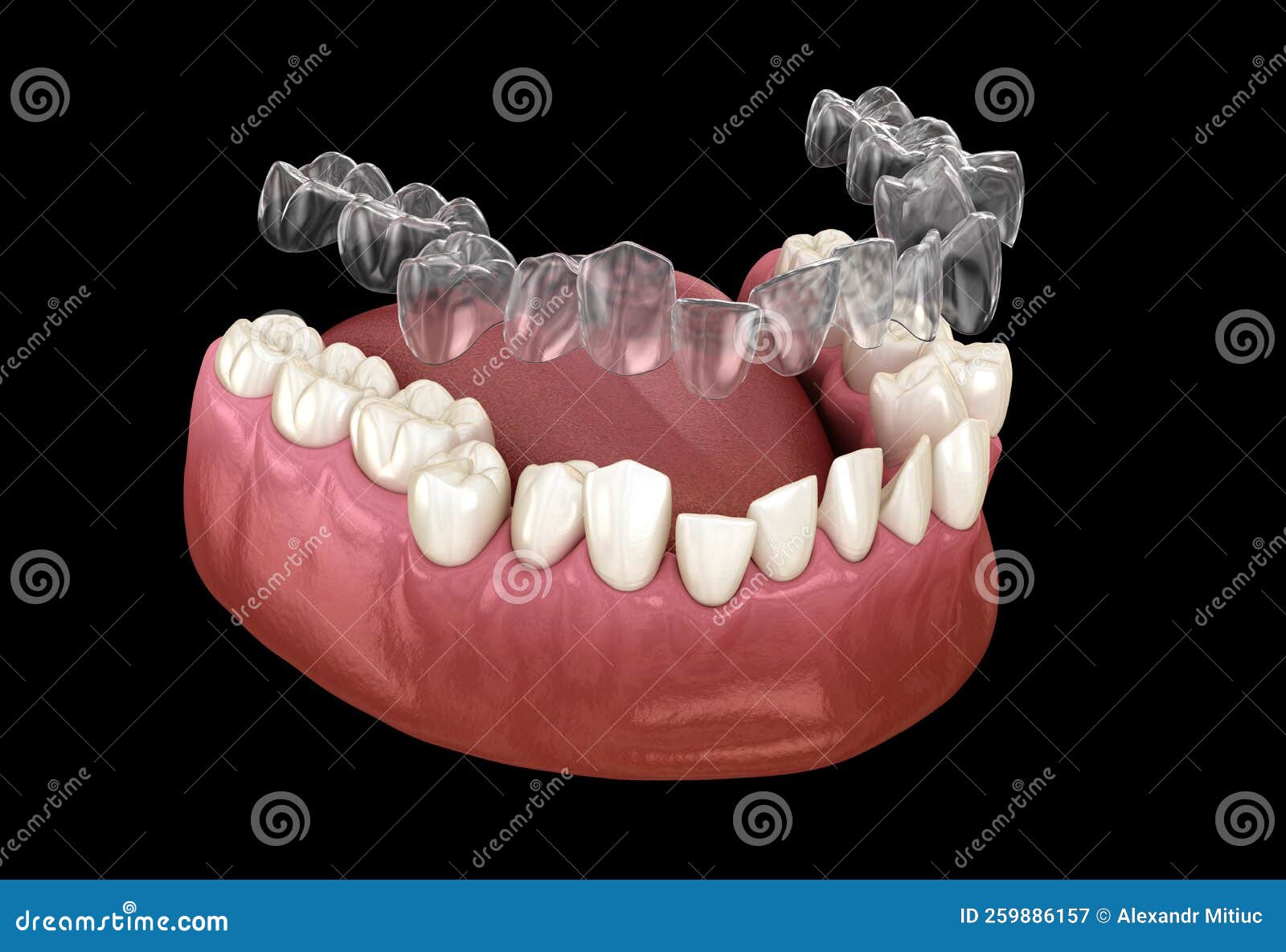 Invisalign Braces or Invisible Retainer Make Bite Correction. Medically ...