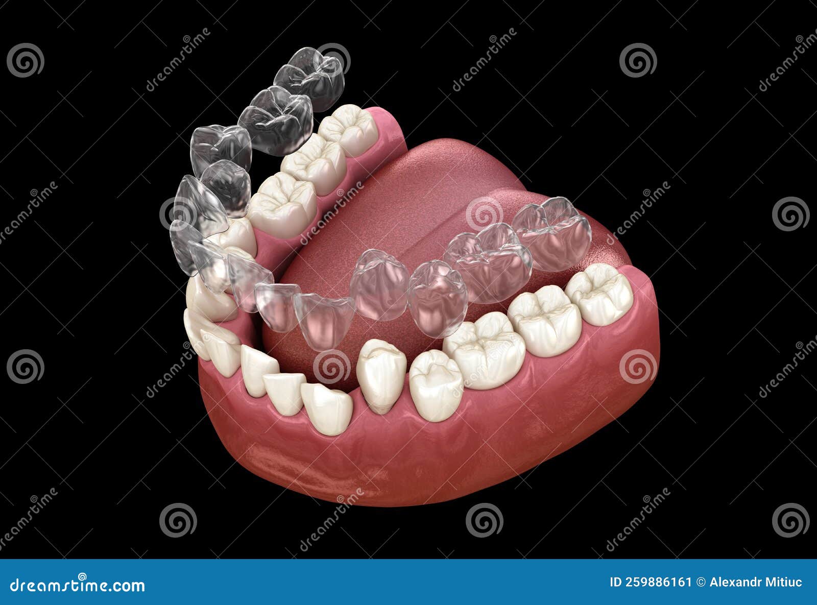 Invisalign Braces or Invisible Retainer Make Bite Correction. Medically ...