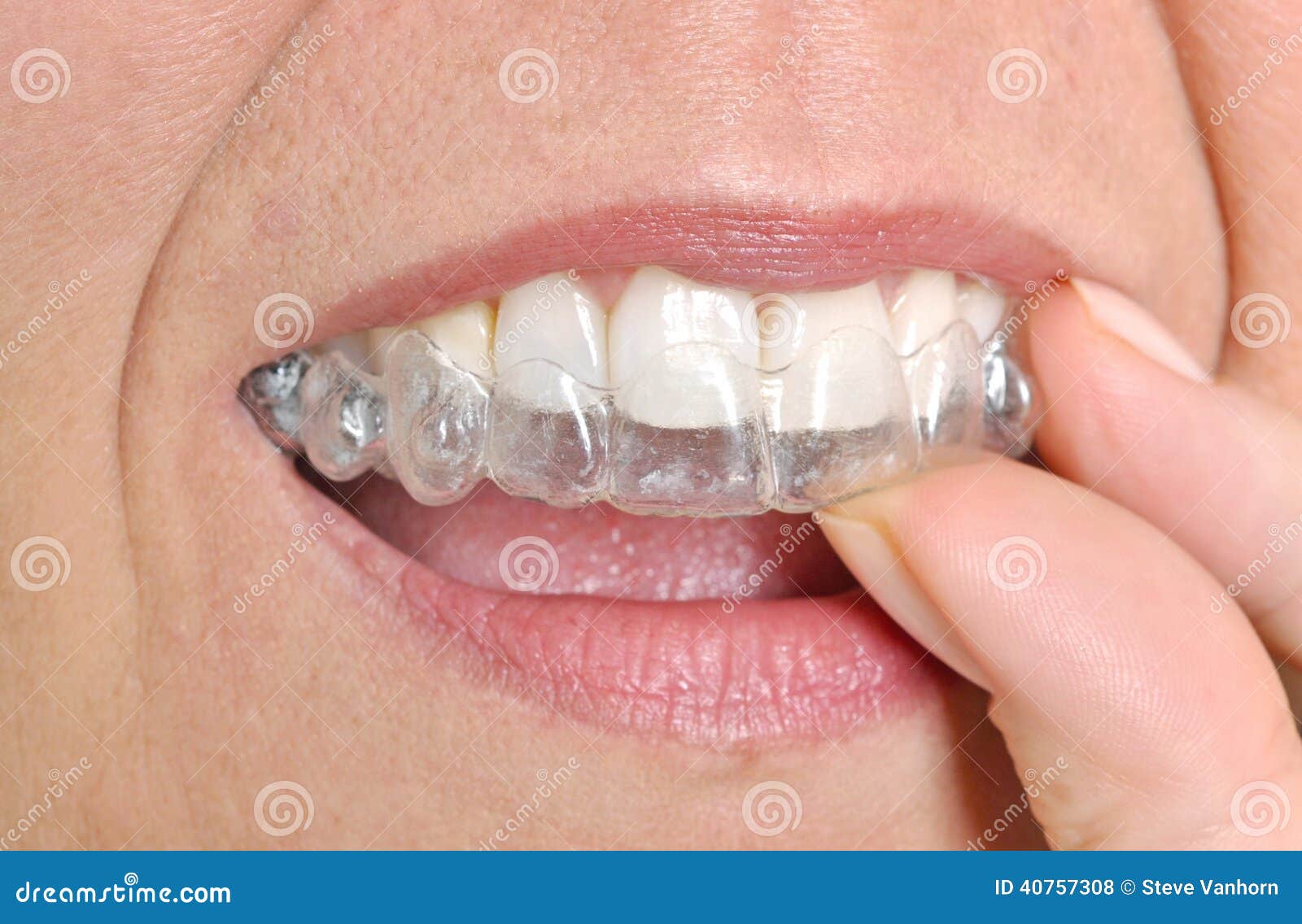 Invisible braces stock photo. Image of orthodontic, hygiene - 40757308