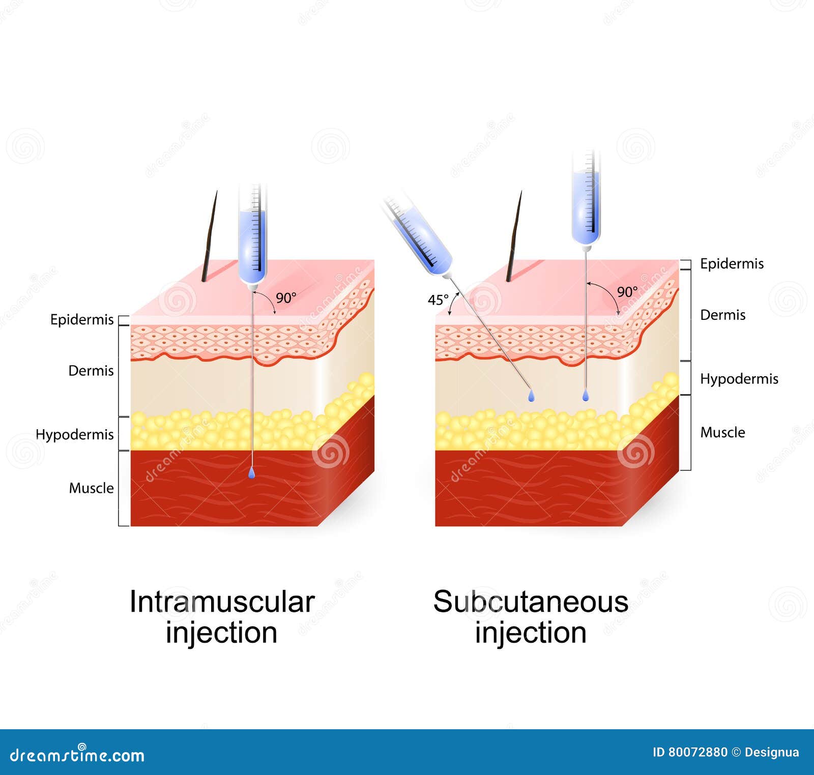 Inyección Intramuscular E Inyección Subcutánea Ilustración del Vector ...