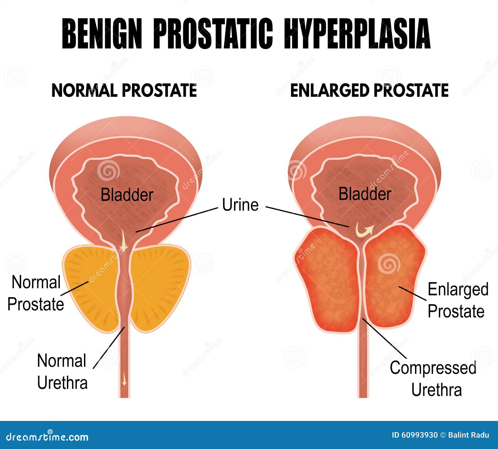 Ipertrofia Prostatica Benigna Sintomi E Terapia Vivere Al Meglio | Hot ... Ipertrofia Prostatica Benigna Sintomi E Terapia Vivere Al Meglio | Hot ...