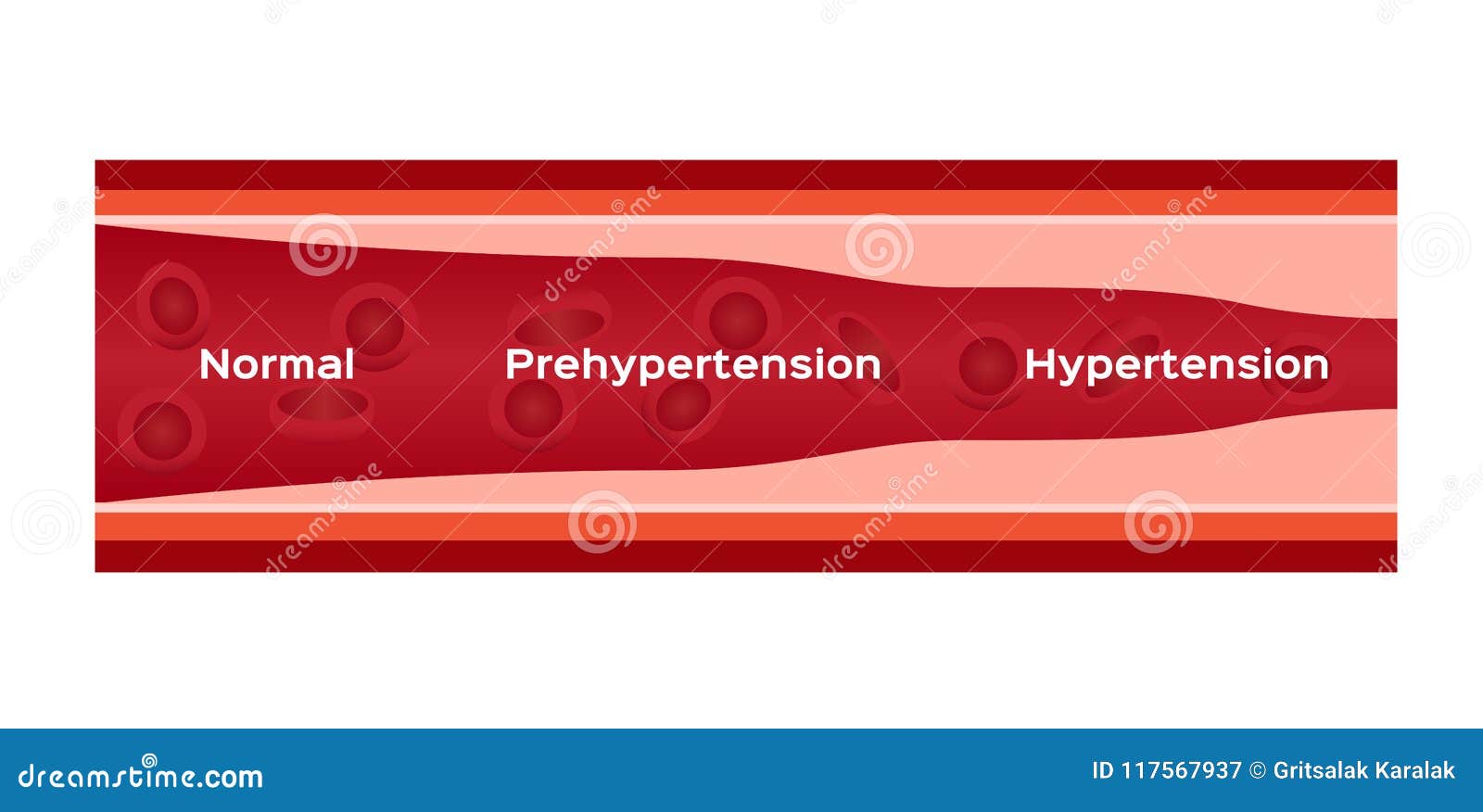 Ipertensione, Ipertensione/anatomia Umana Illustrazione Vettoriale ...