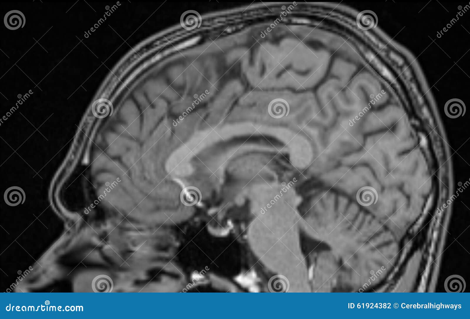 IRM Brain Sagittal View photo stock. Image du humain - 61924382
