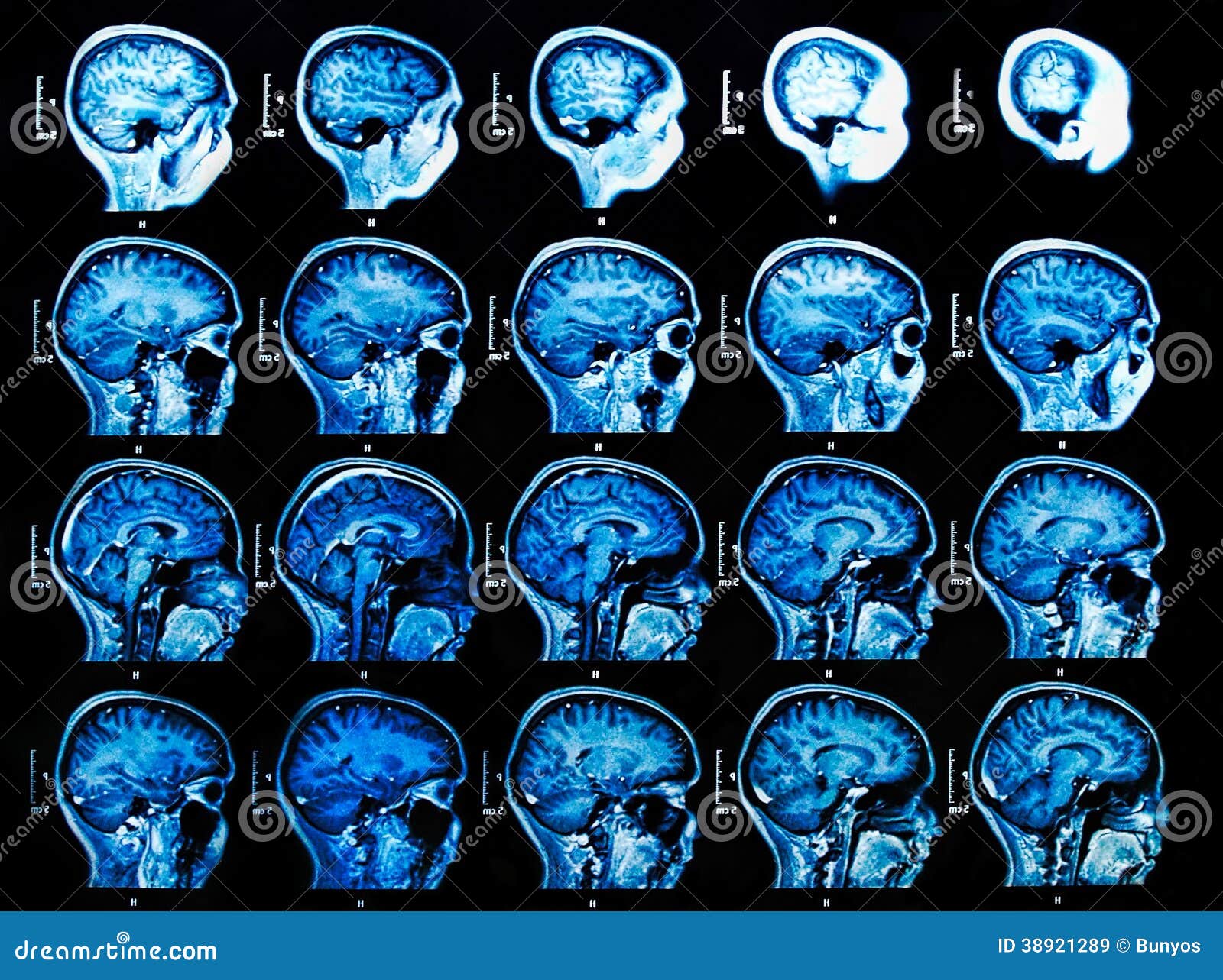 IRM Brain Scan image stock. Image du anatomie, cancer - 38921289