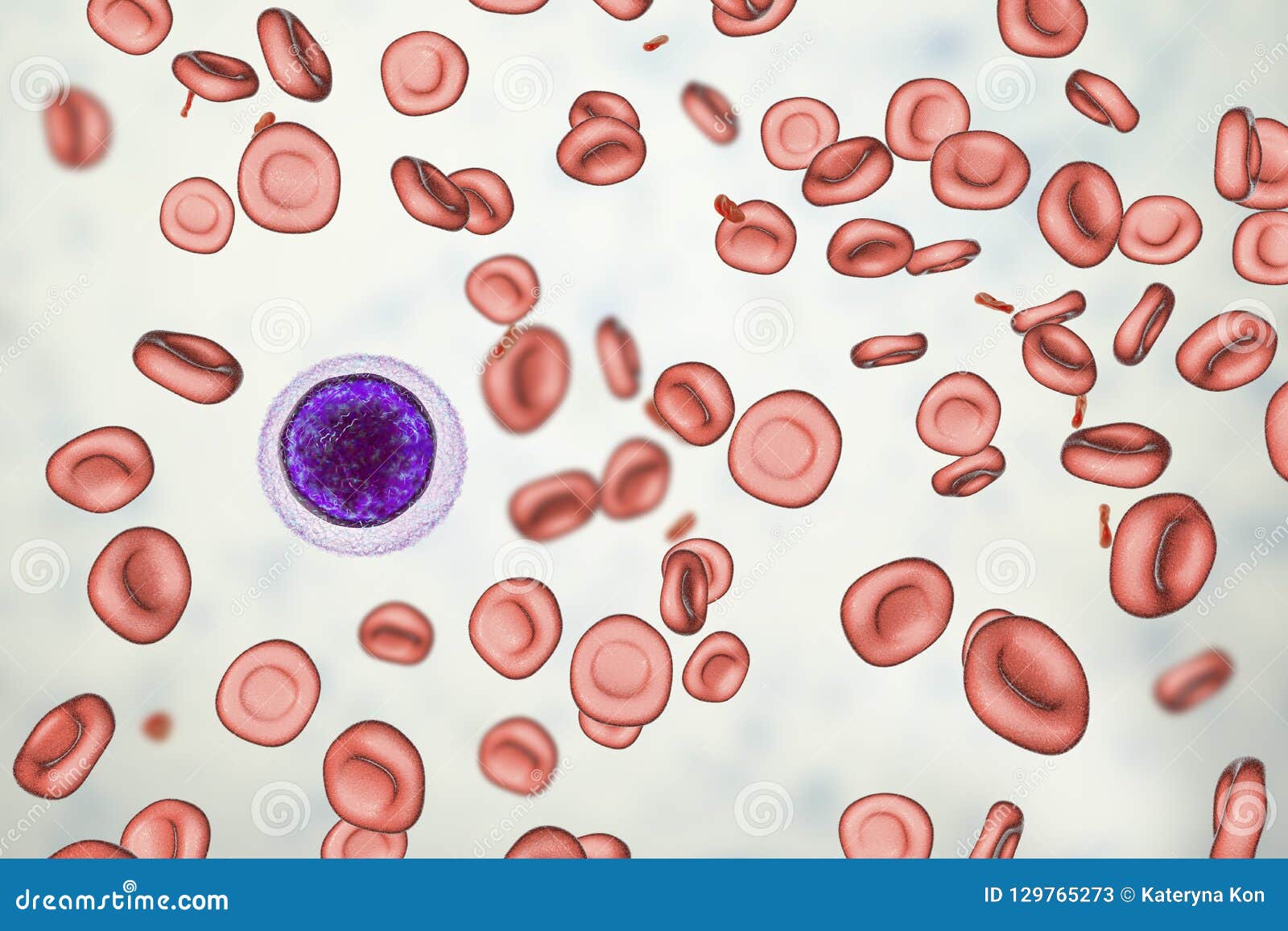 Iron Deficiency Anemia Stock Image Image Of Iron Hematology 129765273