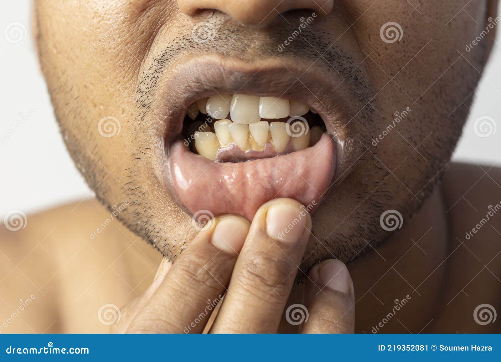 Irregular teeth male stock image. Image of tooth, showing - 219352081