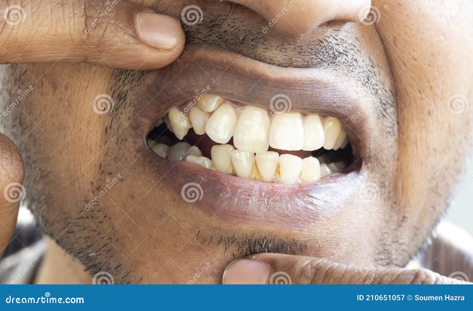 Irregular Teeth of an Indian Man Stock Image - Image of lips, macro ...