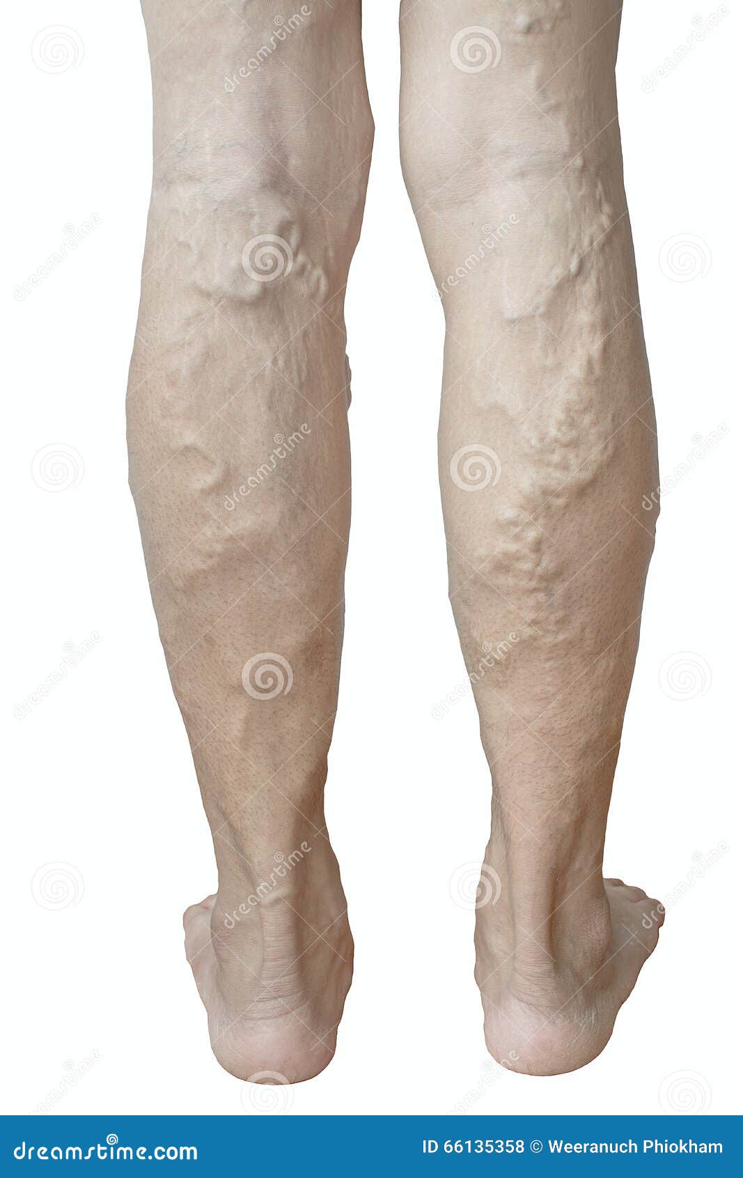 Irregular Varicose Veins On Woman Legs Royalty-Free Stock Image ...