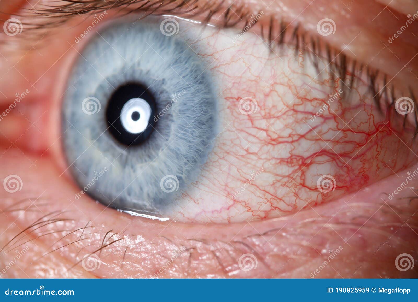 Irritated Male Blue Eye Full with Capillar Net Stock Image - Image of ...