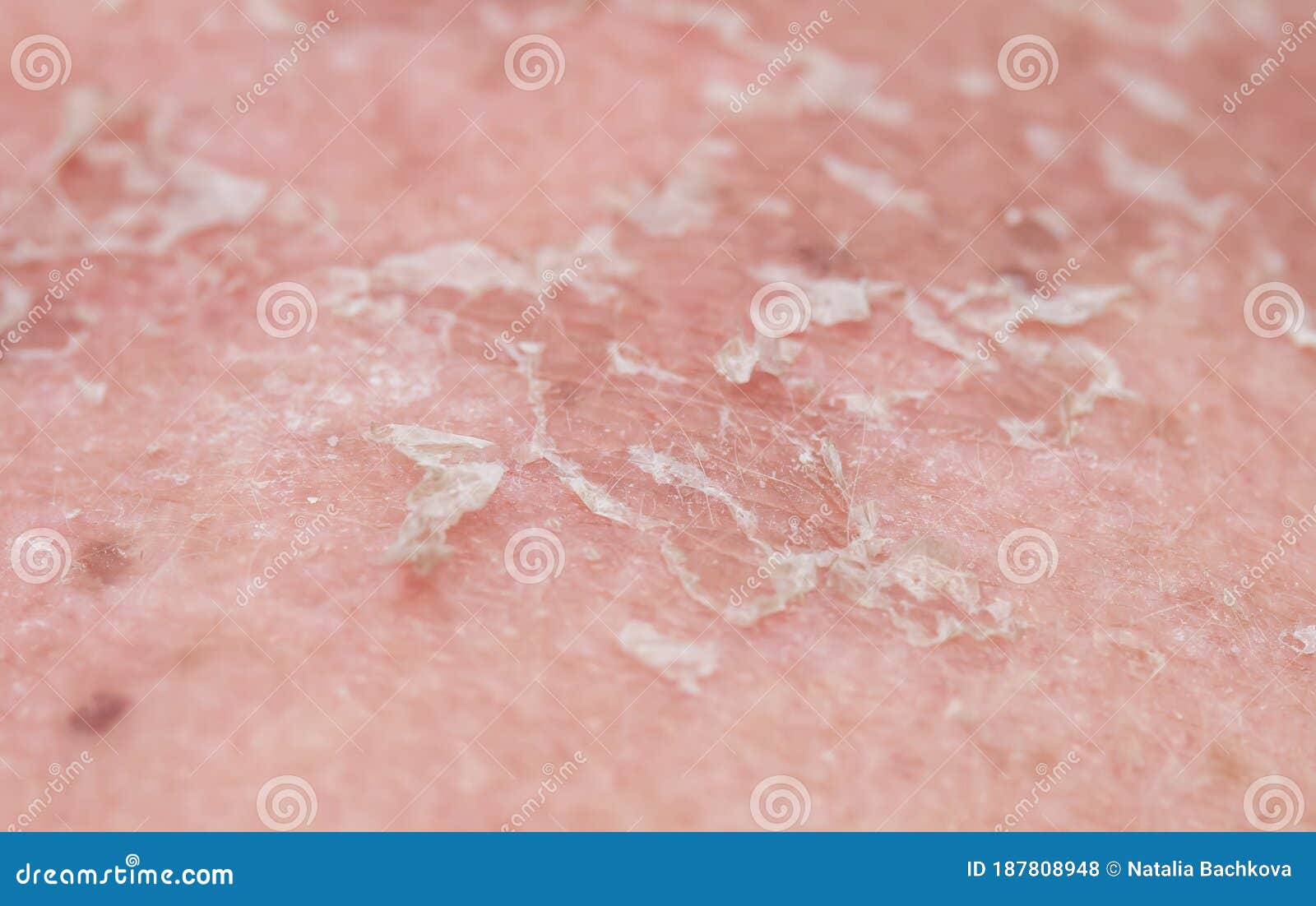 Irritated Reddened Skin With Flaking Scales Of Dead Old Cells After