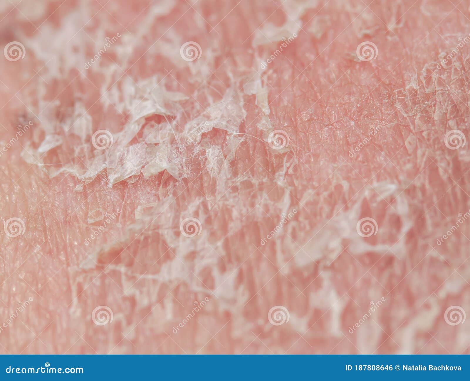 Texture Of Irritated Unhealthy Skin With Scales Of Dead Cells And
