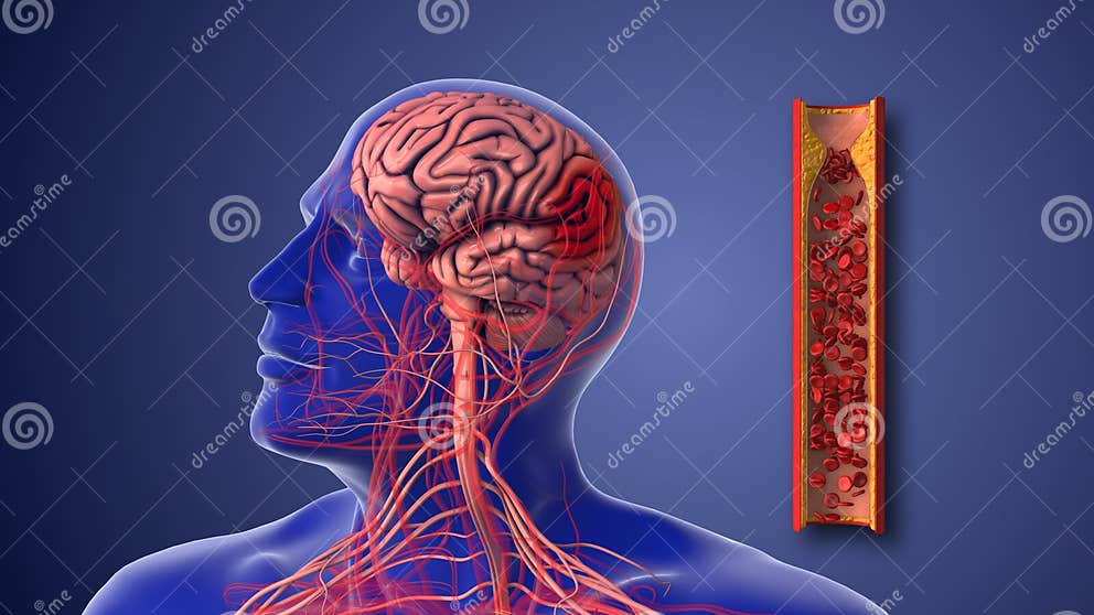 Ischemic Stroke Or Cerebrovascular Disease From Atherosclerotic