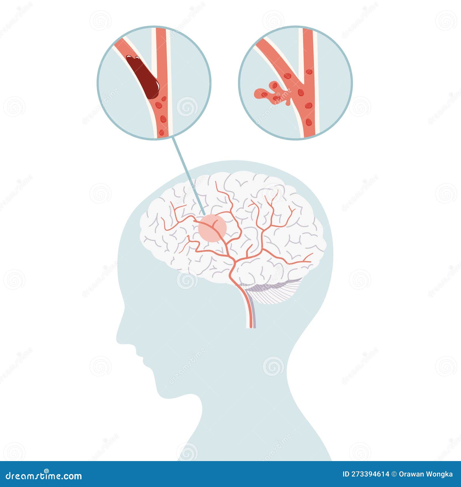 Ischemic Stroke and Hemorrhagic Stroke, Stroke Brain Concept in Flat ...