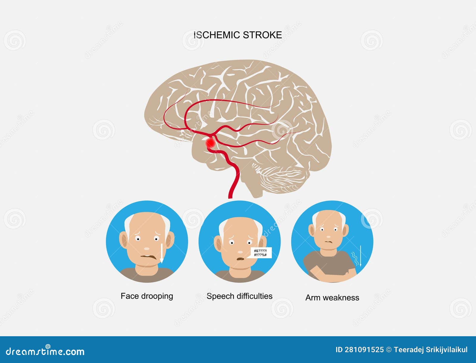 Ischemic Stroke and Waring Signs and Symptoms Stock Illustration ... Ischemic Stroke and Waring Signs and Symptoms Stock Illustration ...