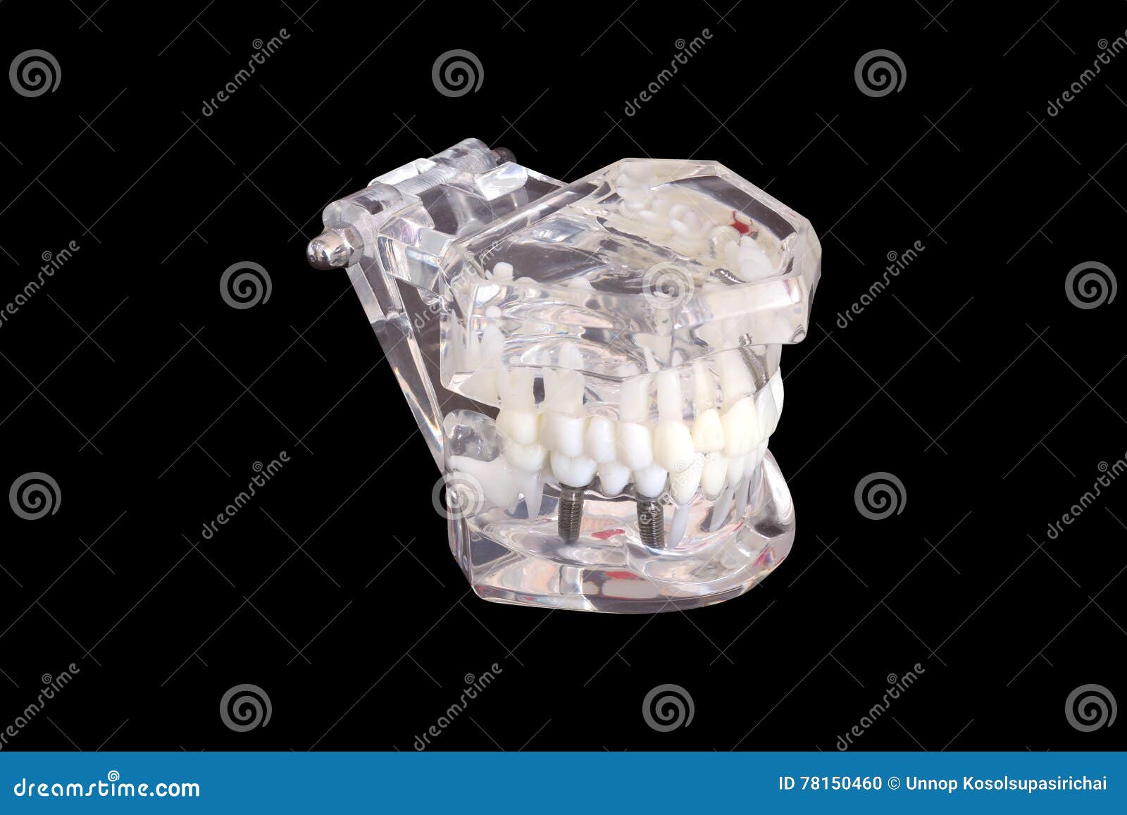 Isolated Dental Tooth Implants in a Mold of a Human Jaw Model on Black ...