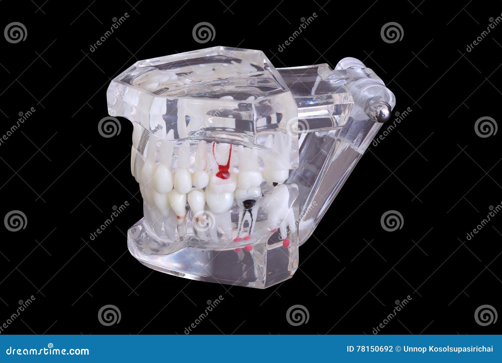 Isolated Dental Tooth Implants in a Mold of a Human Jaw Model on Black ...