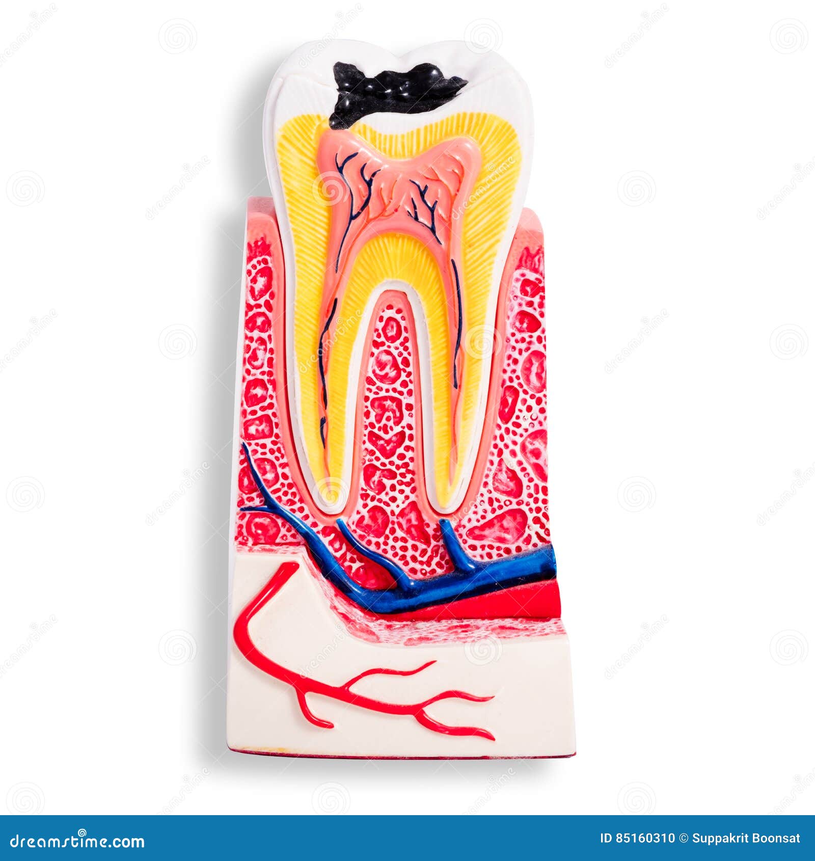Isolated Dentist Demonstration Caries Teeth Model Stock Photo - Image ...
