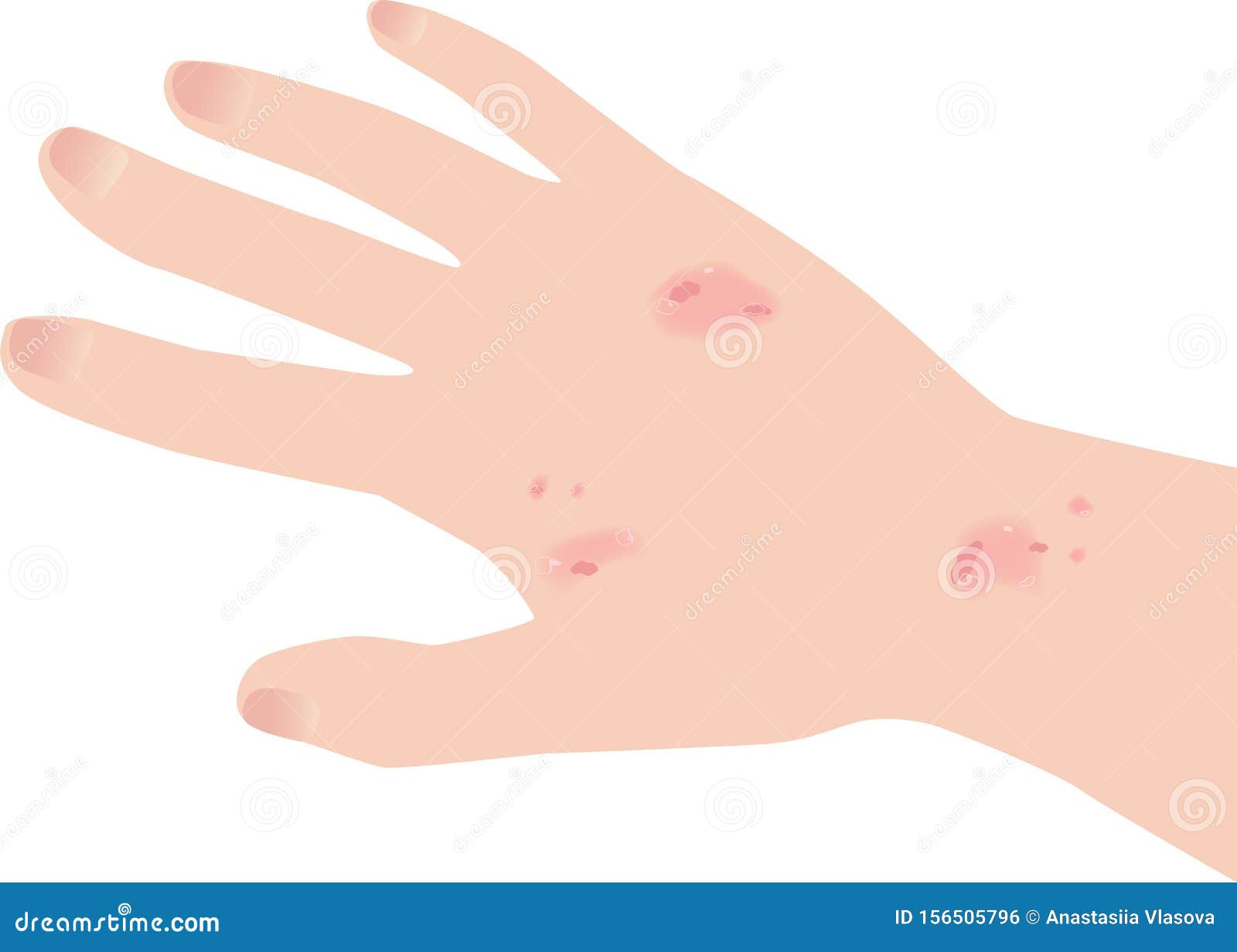Isolated Hand with Skin Problems Stock Vector - Illustration of redness ...