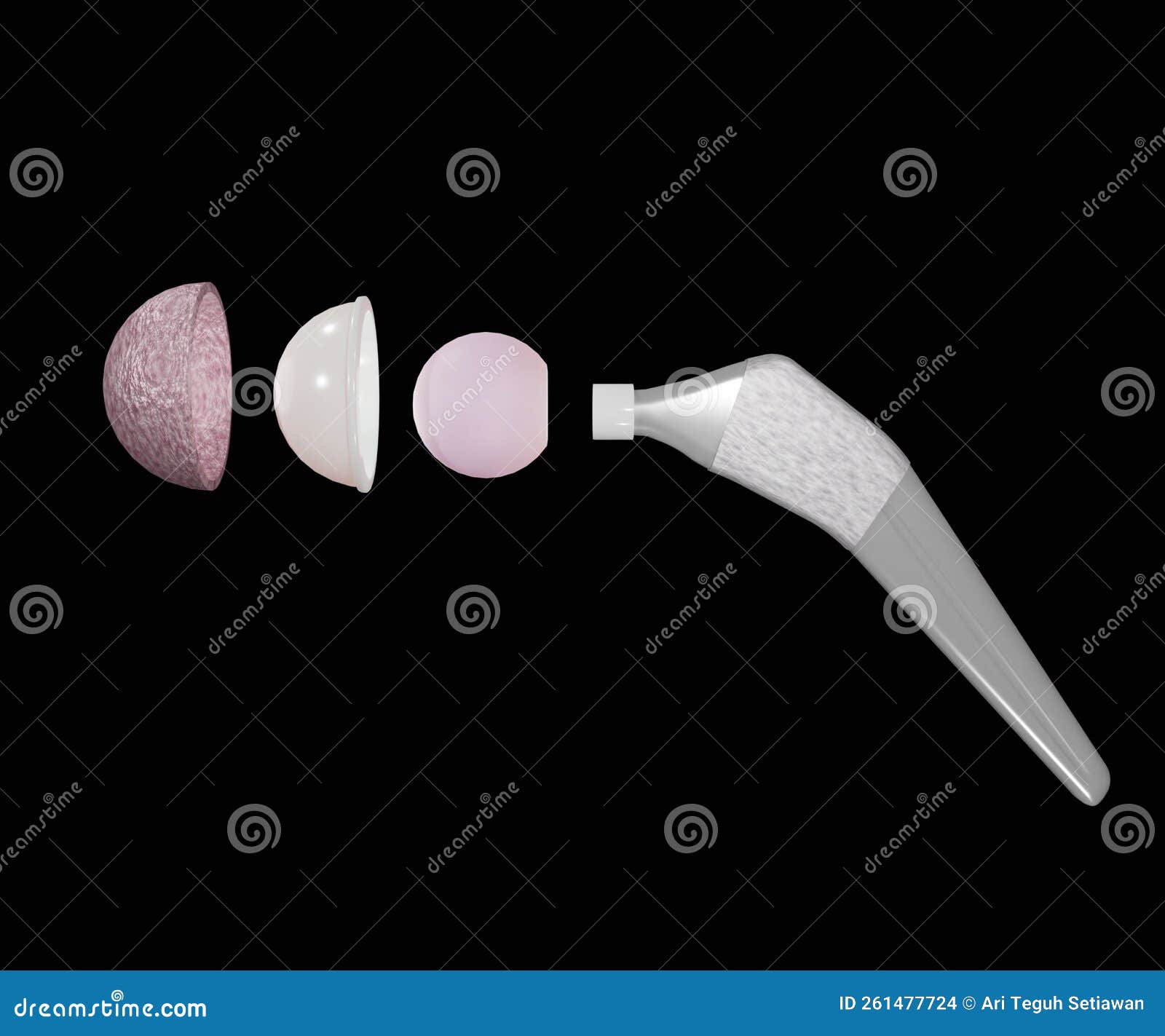 Total Hip Replacement Components and Examples of Commercial Hip Stem ...