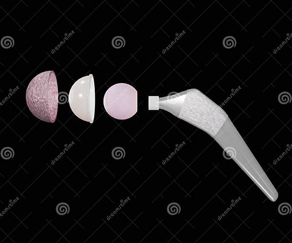 Total Hip Replacement Components and Examples of Commercial Hip Stem ...