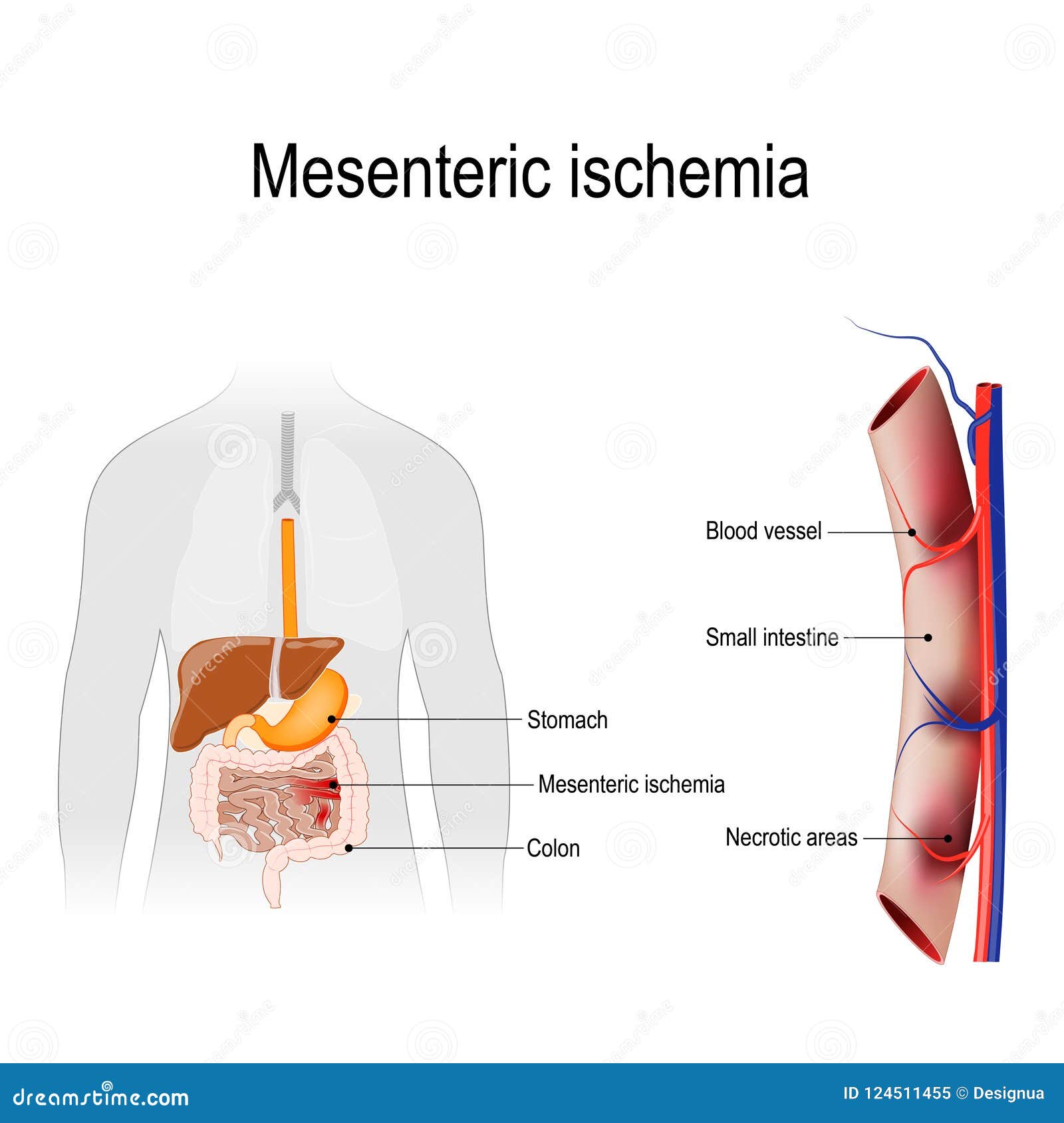 Isquemia Mesenteric ilustração do vetor. Ilustração de pequeno - 124511455