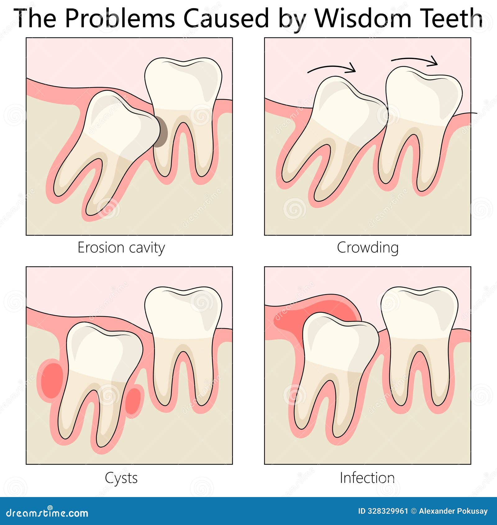 Problems Caused by Wisdom Teeth Diagram Medical Stock Illustration ...
