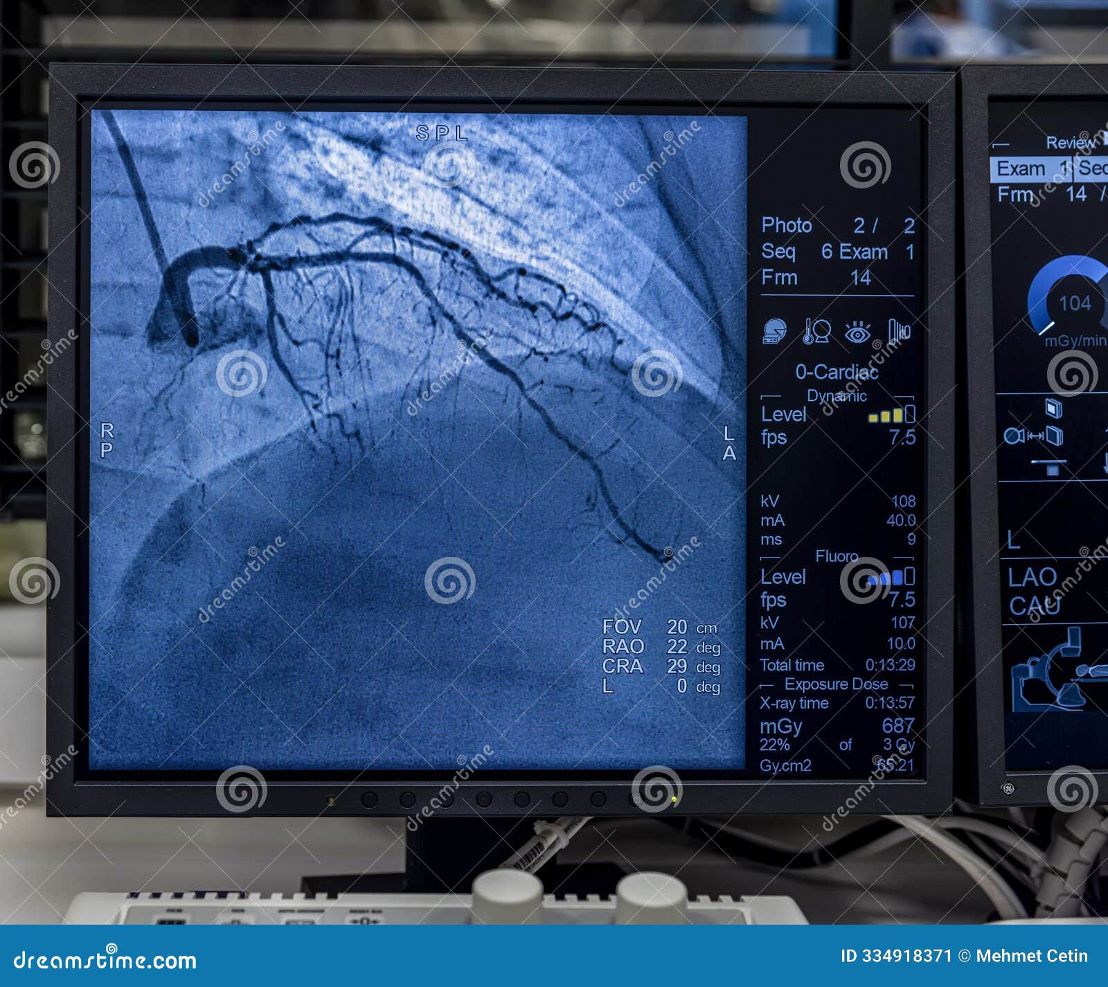 Angiogram Sequence Working Clockwise Using X-rays With A Contrast Agent ...
