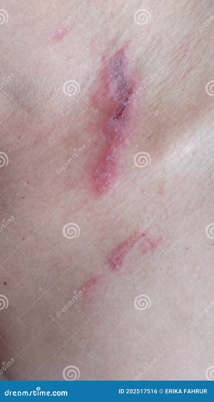 Itching Disease in the Human Body Stock Photo - Image of human, violet ...