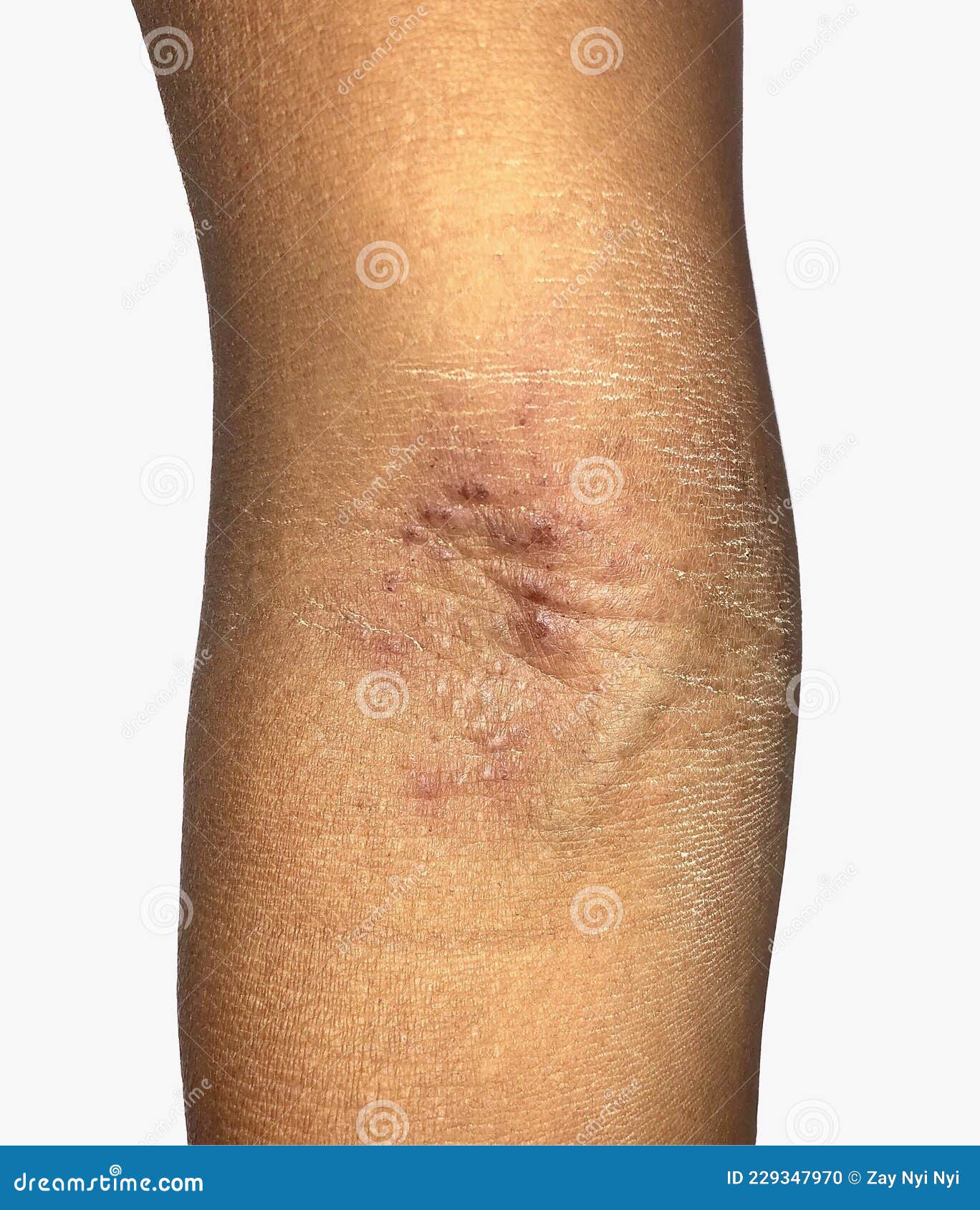 Ringworm Red Patches. Skin Infection Stock Image | CartoonDealer.com ...