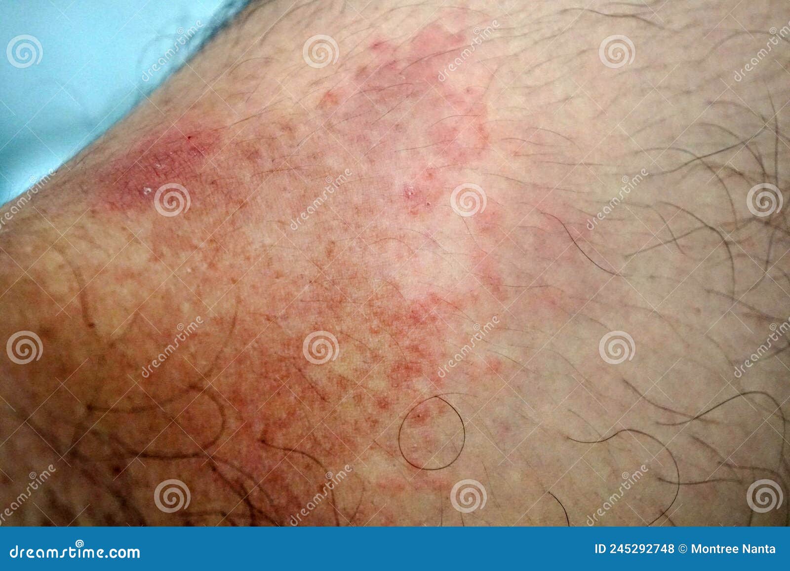 Itchy Rash In The Groin Area Tinea Cruris Is A Type Of Skin Disease That Occurs In The Groin
