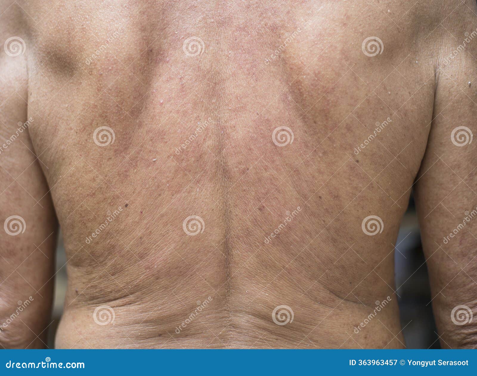 Itchy Rash, Red Bumps On Human Skin Stock Image | CartoonDealer.com ...