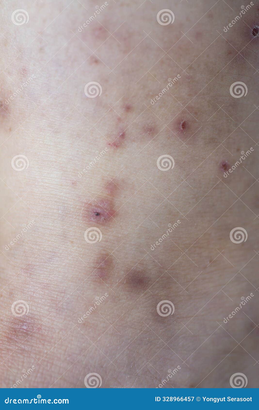 Itchy rash on the skin stock image. Image of ailing - 328966457