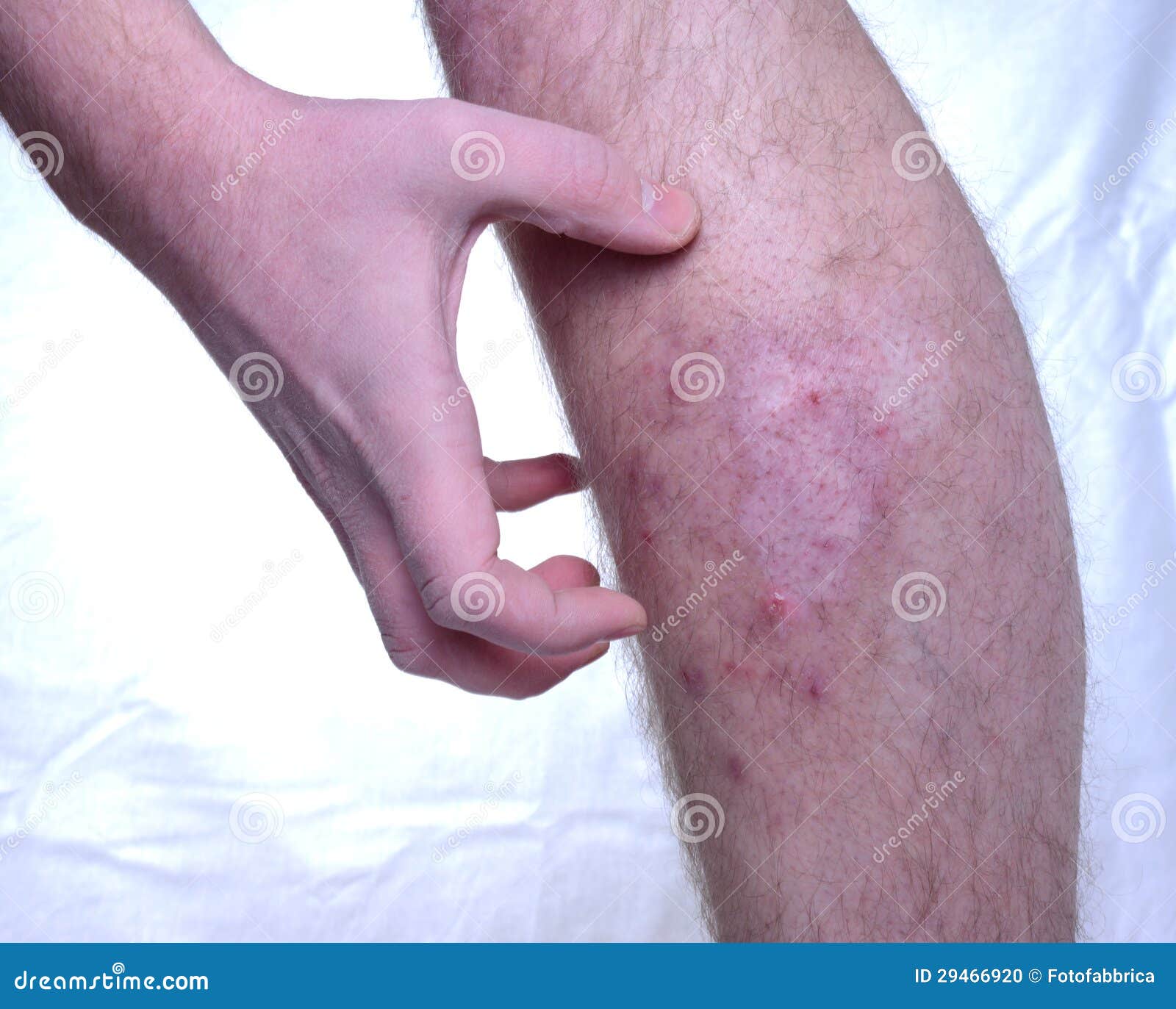 Itchy skin disease stock photo. Image of scratching, peeling - 29466920
