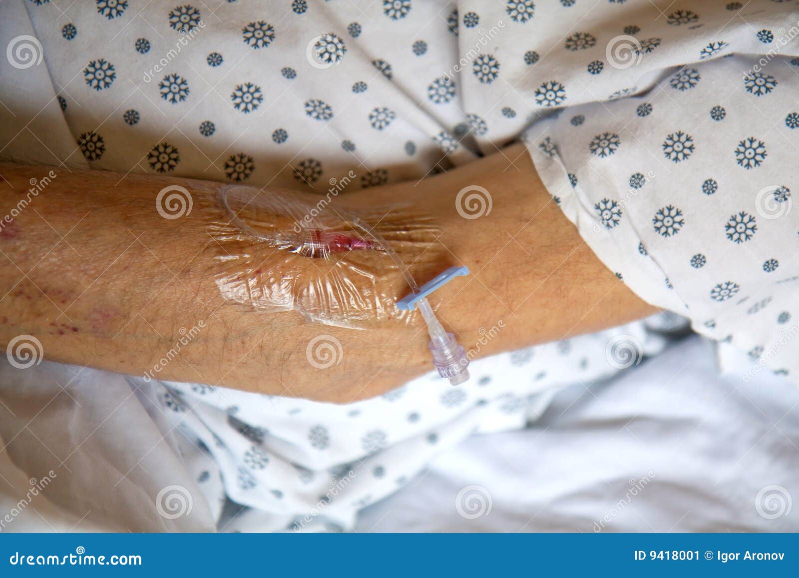 IV in the arm stock image. Image of patient, illness, medicine - 9418001