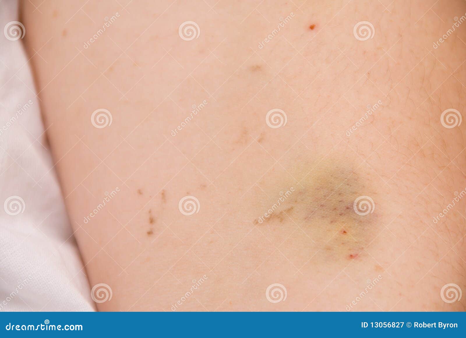 IV equimose imagem de stock. Imagem de trauma, preto - 13056827