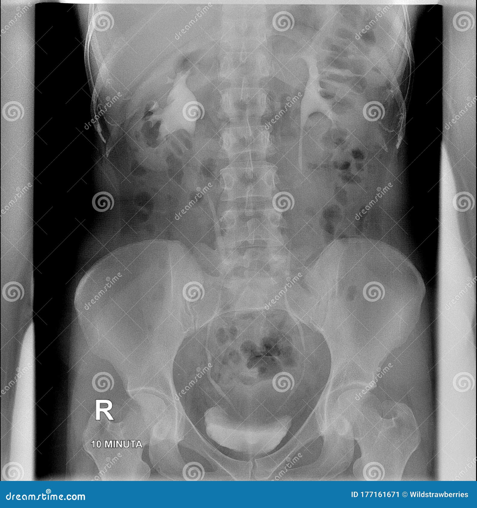 Ivp Intravenous Pyelogram Ten Minutes After Administration Of
