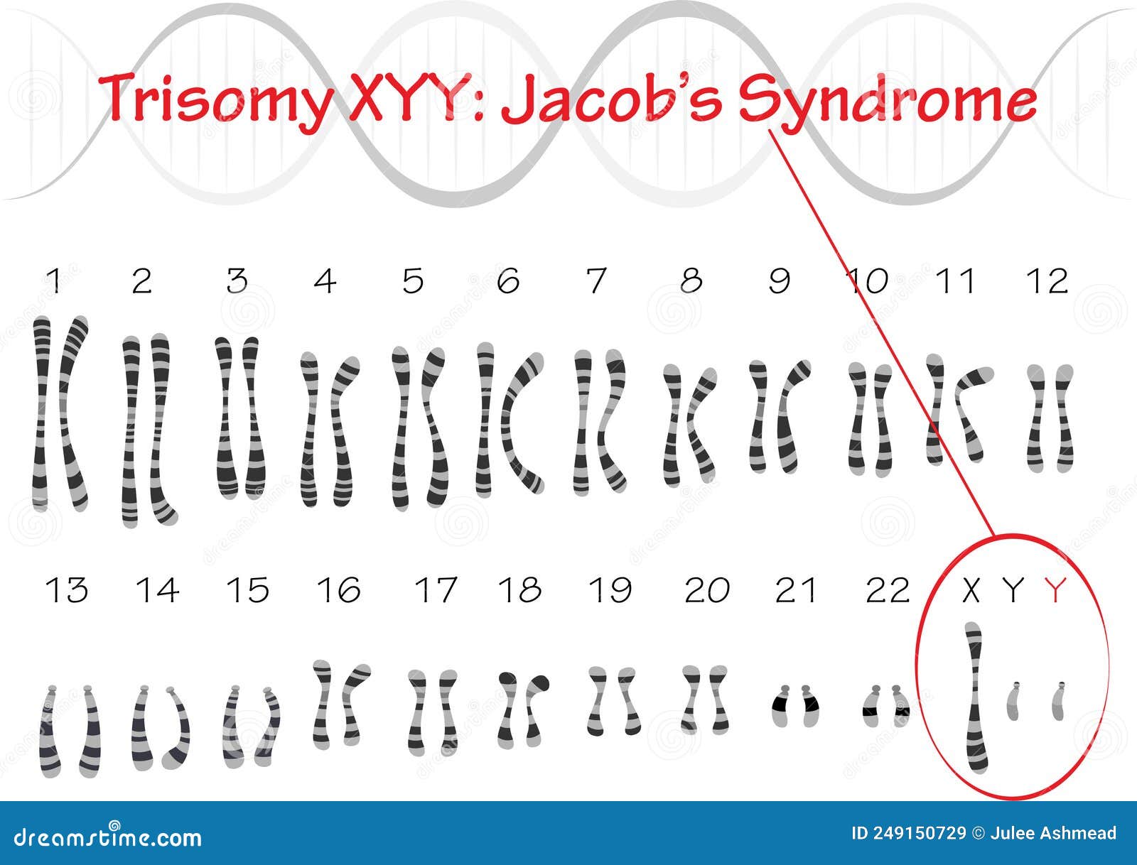 Jacobs Syndrome Trisomy XYY Vector Illustration Graphic Stock Vector ...
