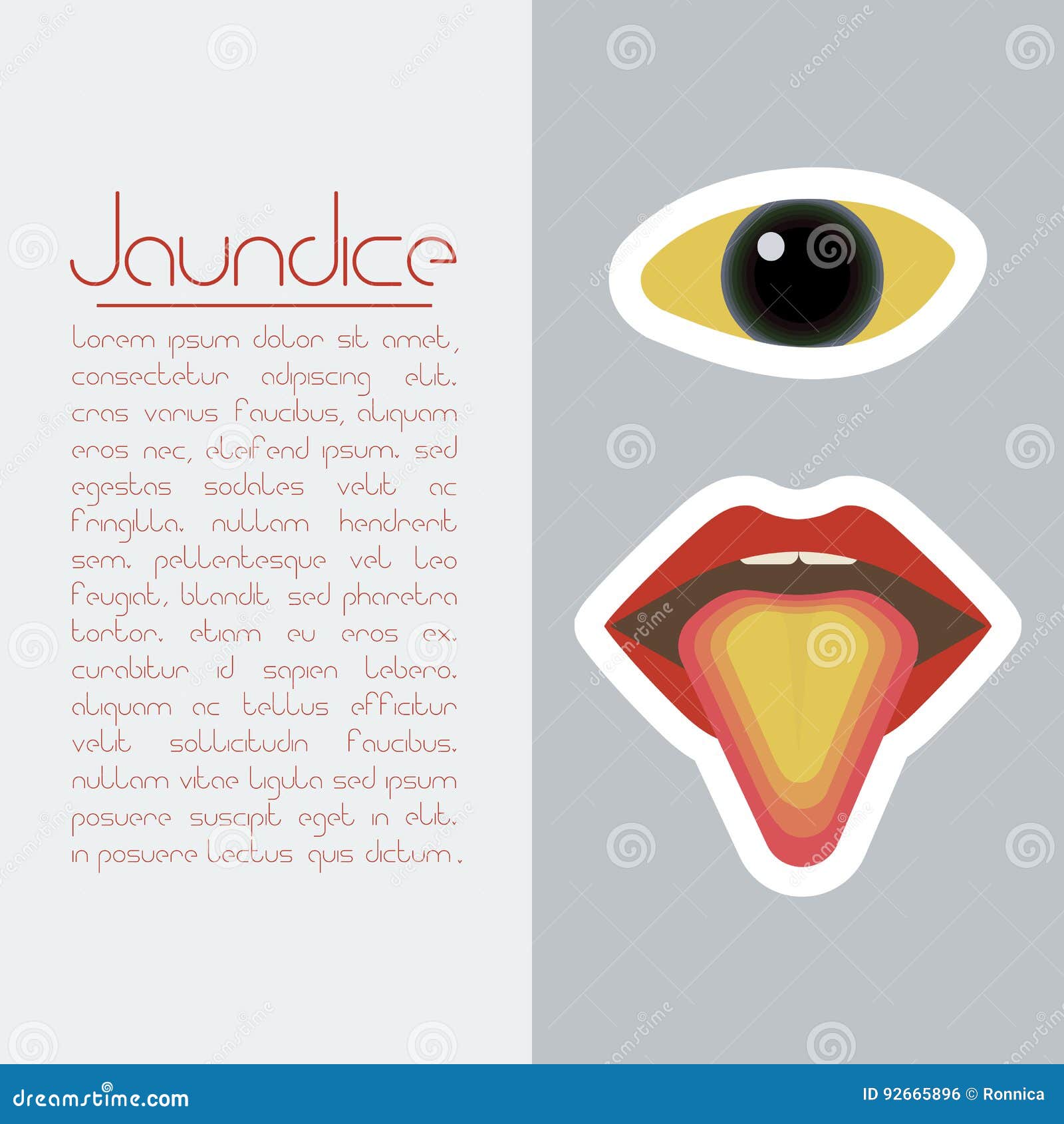 Jaundice Concept. Vector Illustration Stock Vector - Illustration of ... Jaundice Concept. Vector Illustration Stock Vector - Illustration of ...