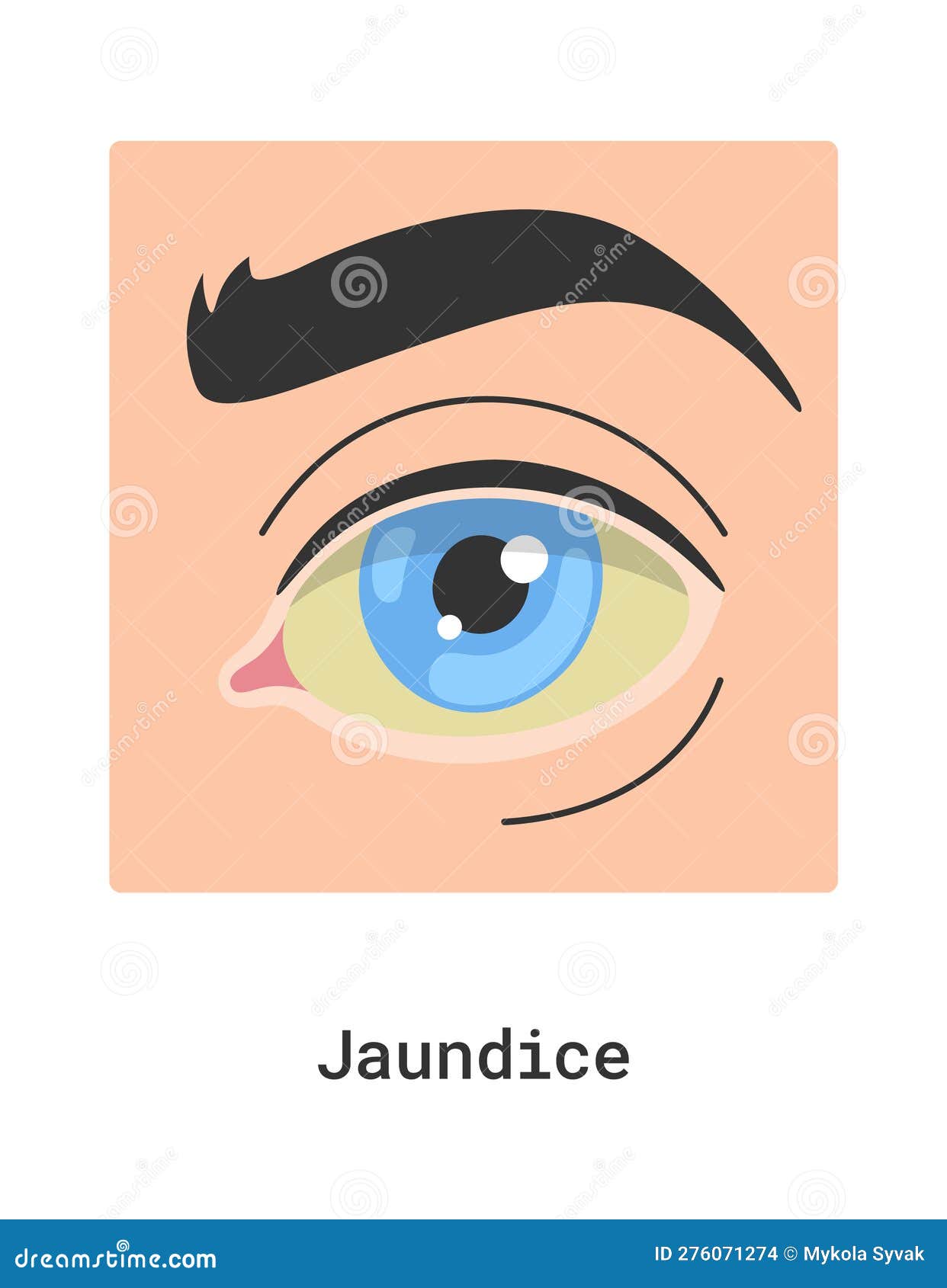 Jaundice Human Eye Disease stock vector. Illustration of virus - 276071274 Jaundice Human Eye Disease stock vector. Illustration of virus - 276071274