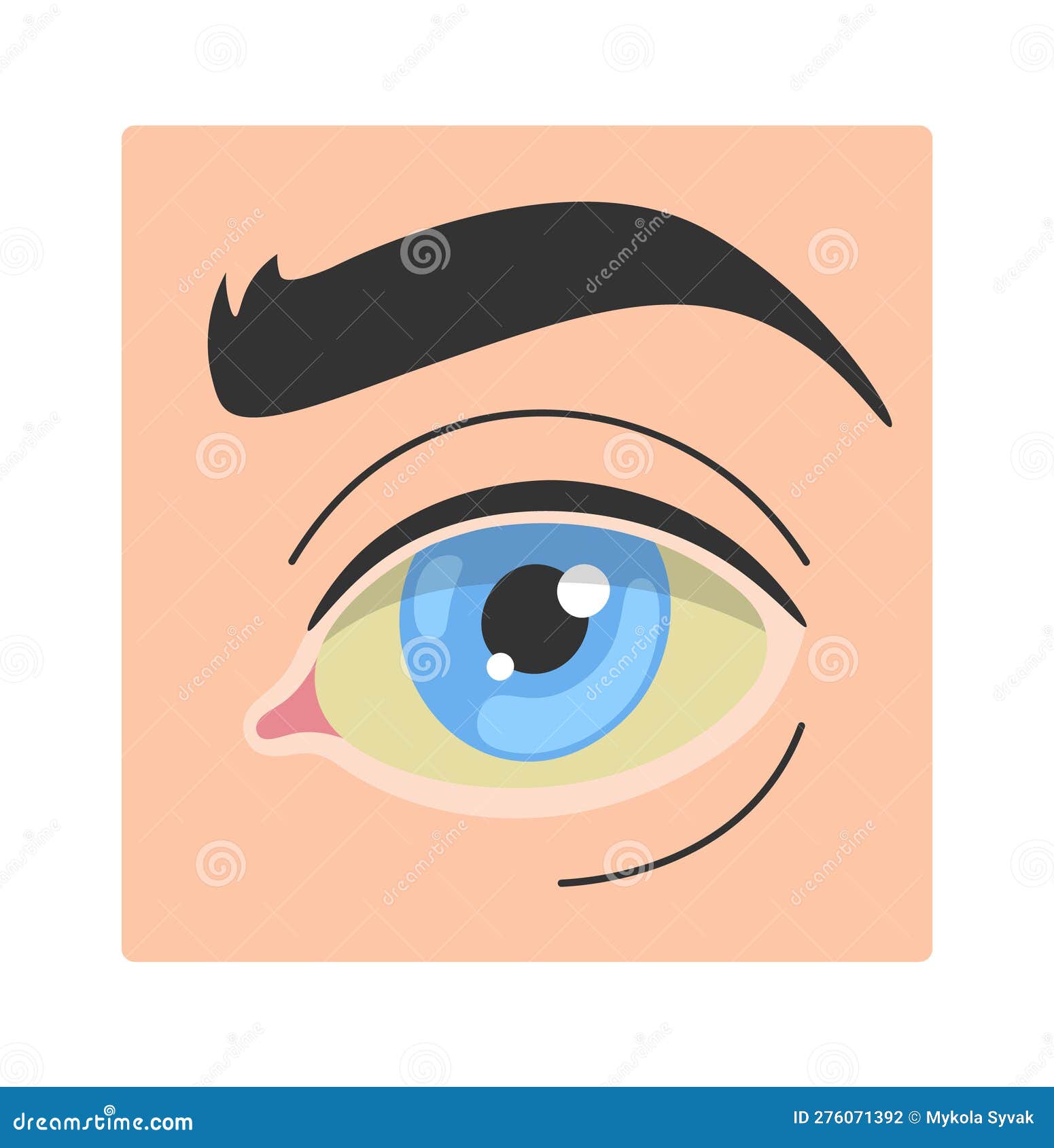 Jaundice Human Eye Disease stock vector. Illustration of medicine ... Jaundice Human Eye Disease stock vector. Illustration of medicine ...