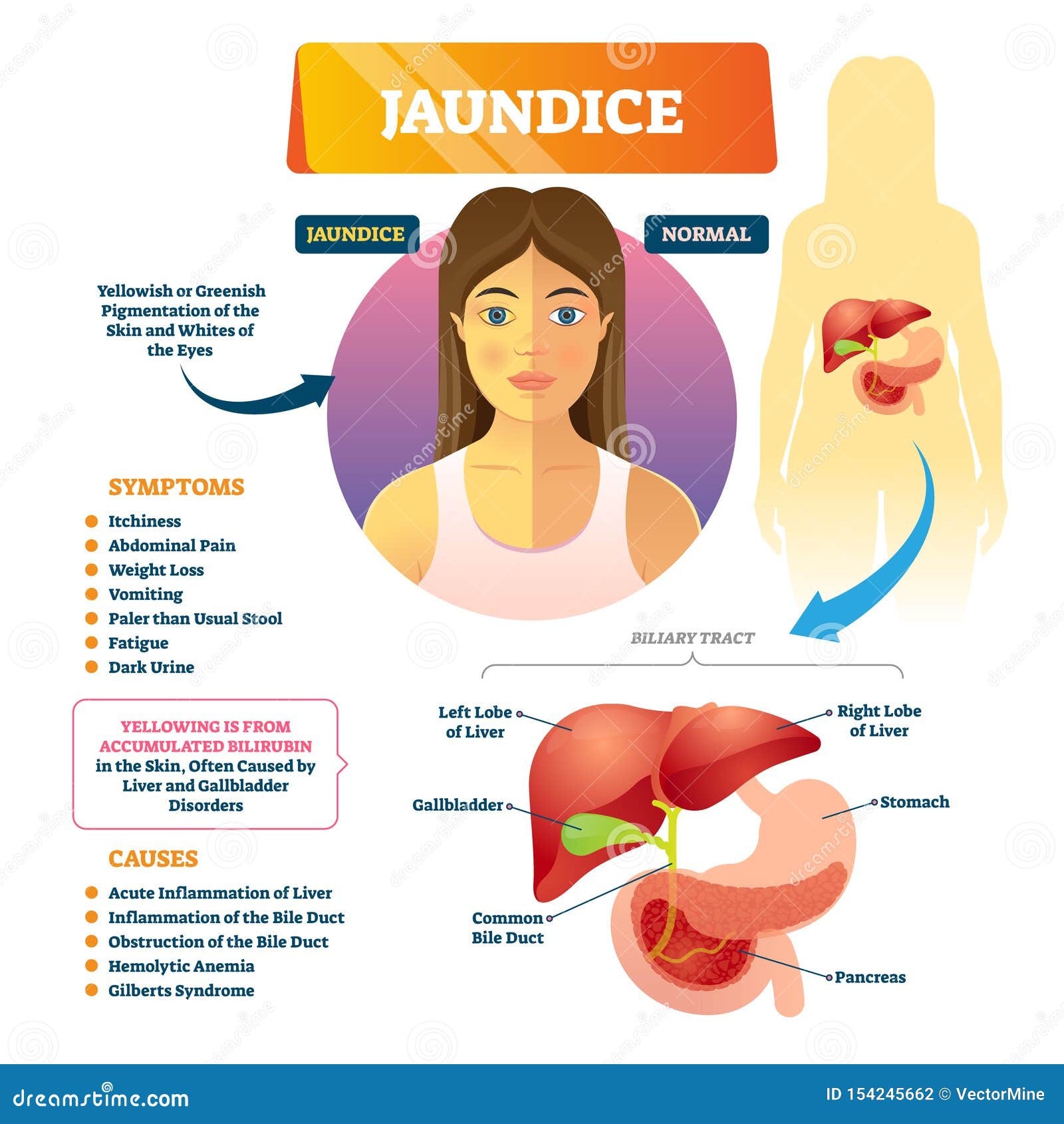 Jaundice or Icterus Vector Illustration. Labeled Yellowish Disease ... Jaundice or Icterus Vector Illustration. Labeled Yellowish Disease ...