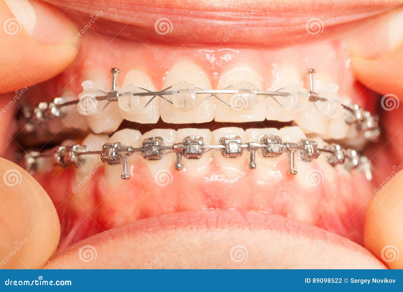 Jaw with Braces Installed on Teeth Closeup View Stock Photo - Image of ...