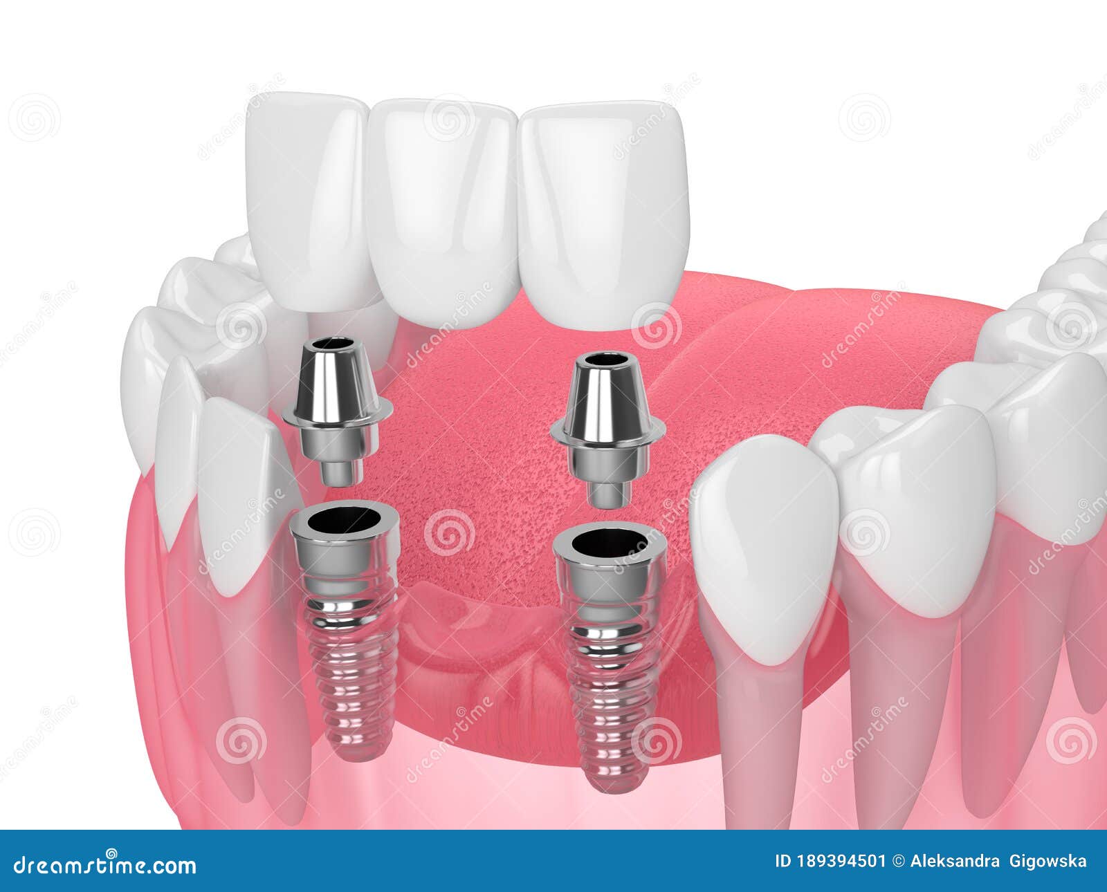 Jaw with Implants Supporting Dental Bridge Over White Stock ...