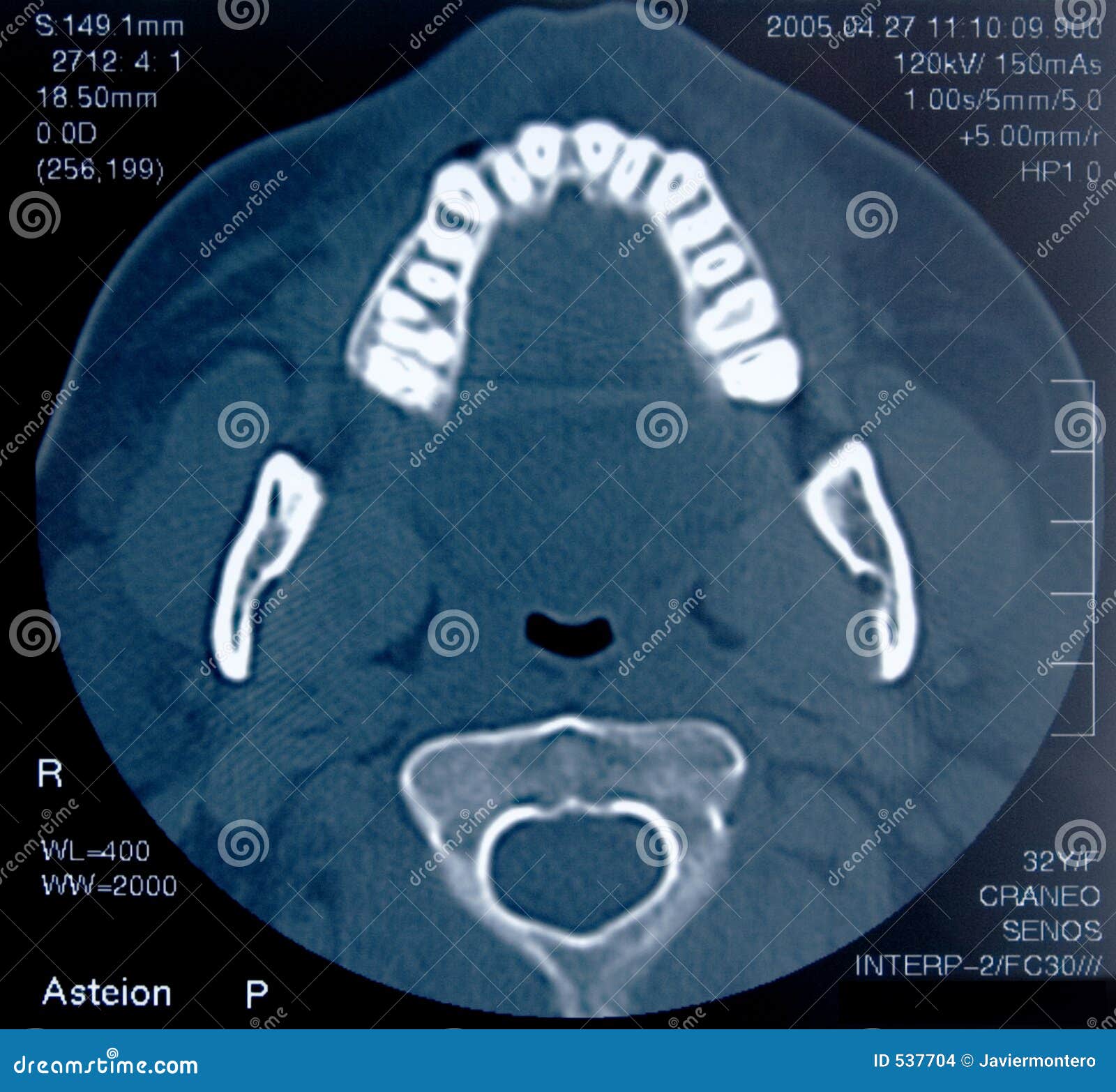 Jaw tomography stock photo. Image of nasal, intracranial - 537704