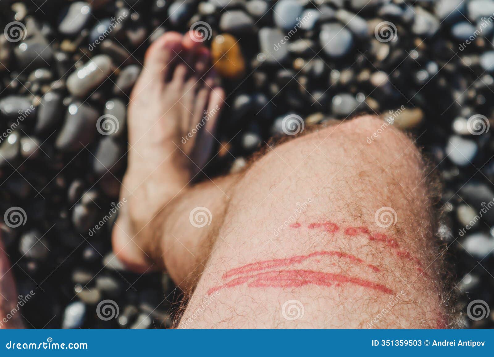 A Jellyfish Sting Burn on a Man S Leg Stock Image - Image of burn, hand ...