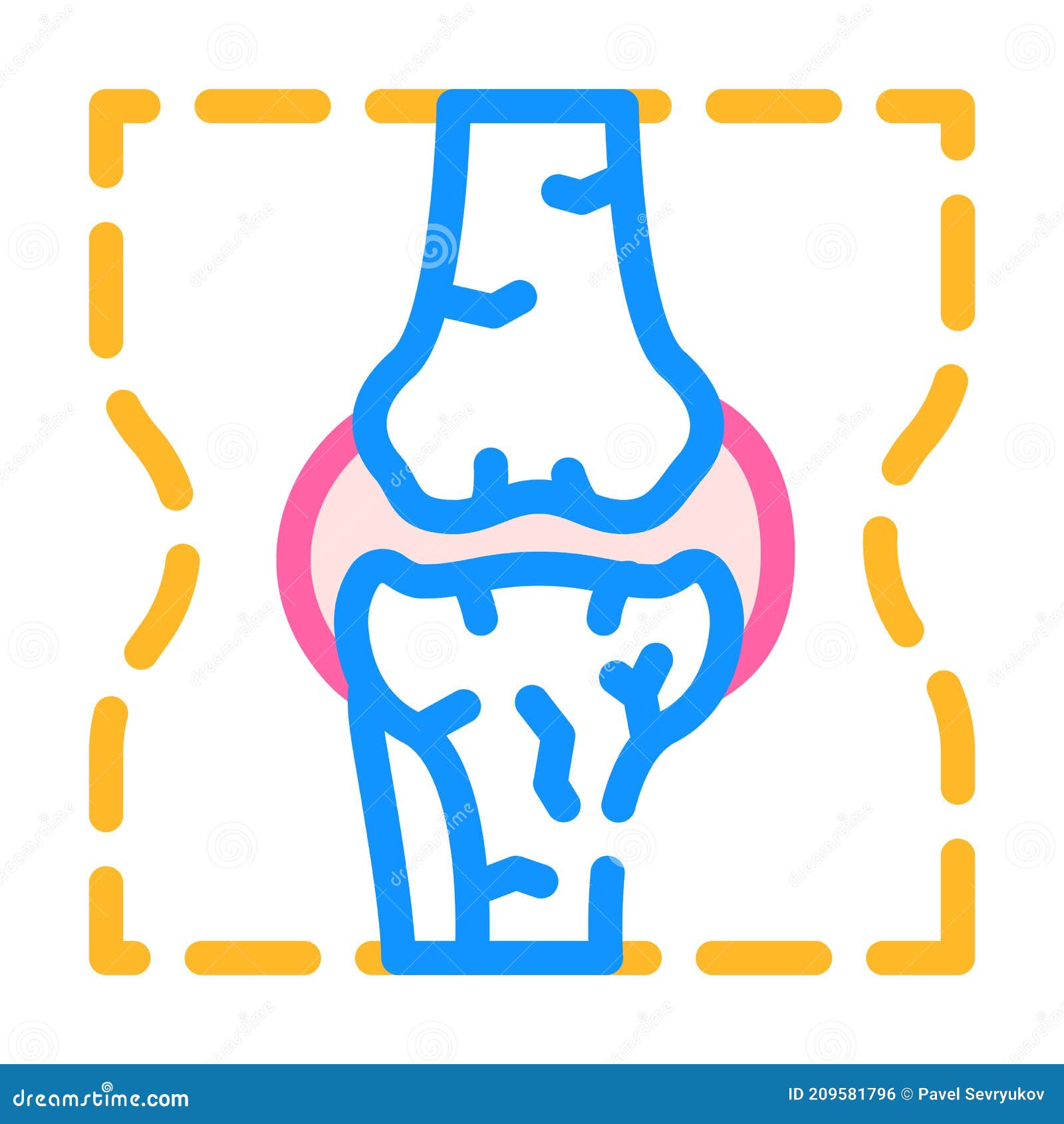Hip Joint Problem_Cam Femoroacetabular Impingement Vector Illustration ...