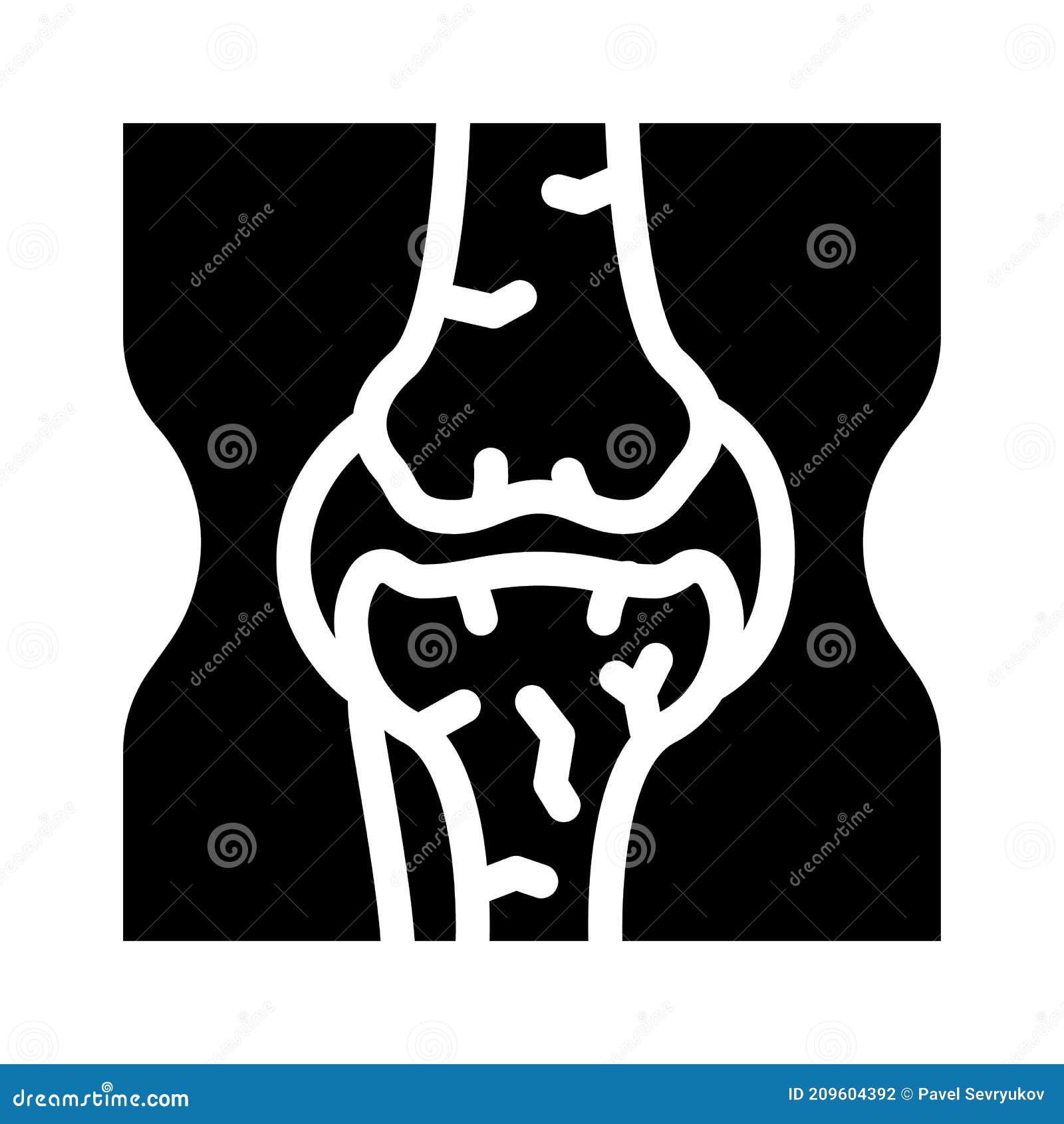Hip Joint Problem_Pincer Femoroacetabular Impingement With Section ...