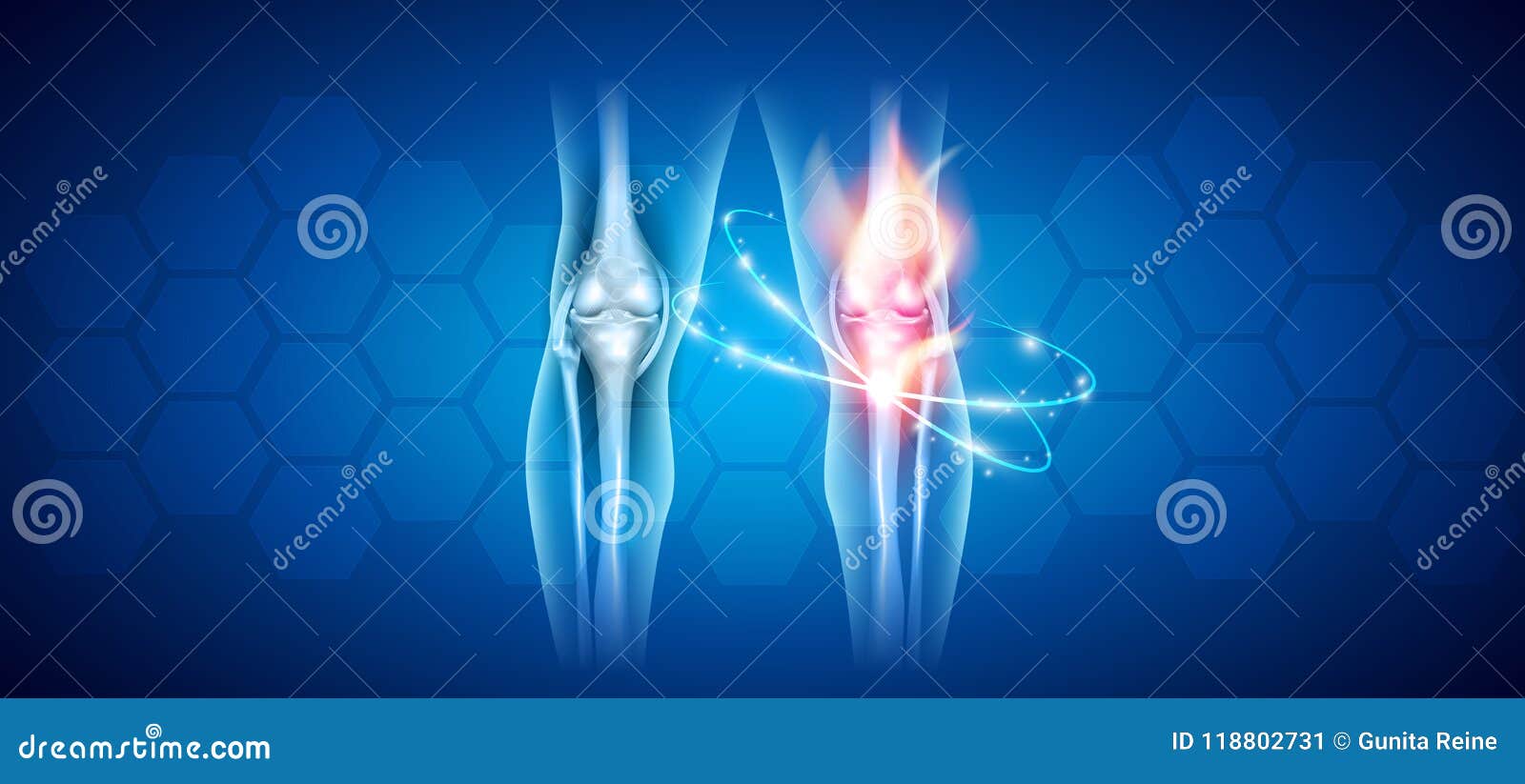 Joint Problems and Treatment Stock Vector - Illustration of ...